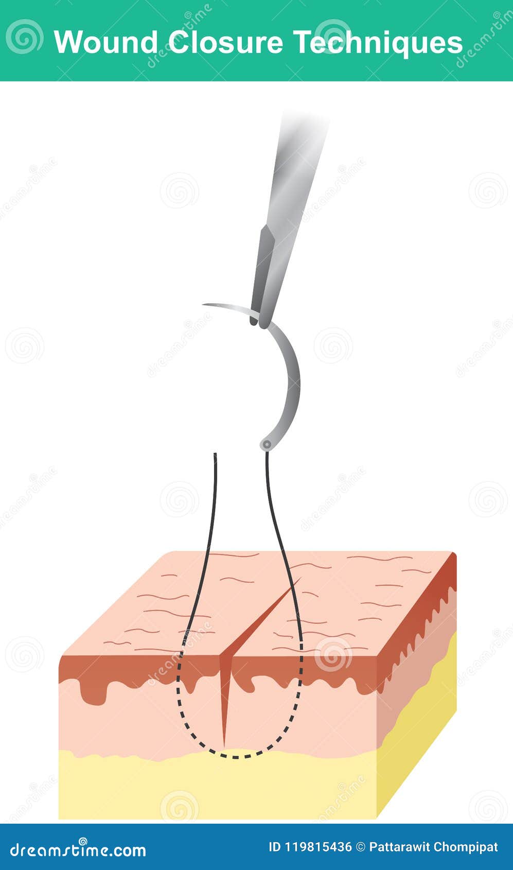 Wound Closure Techniques Isolate. Illustration Infographic. Stock ...