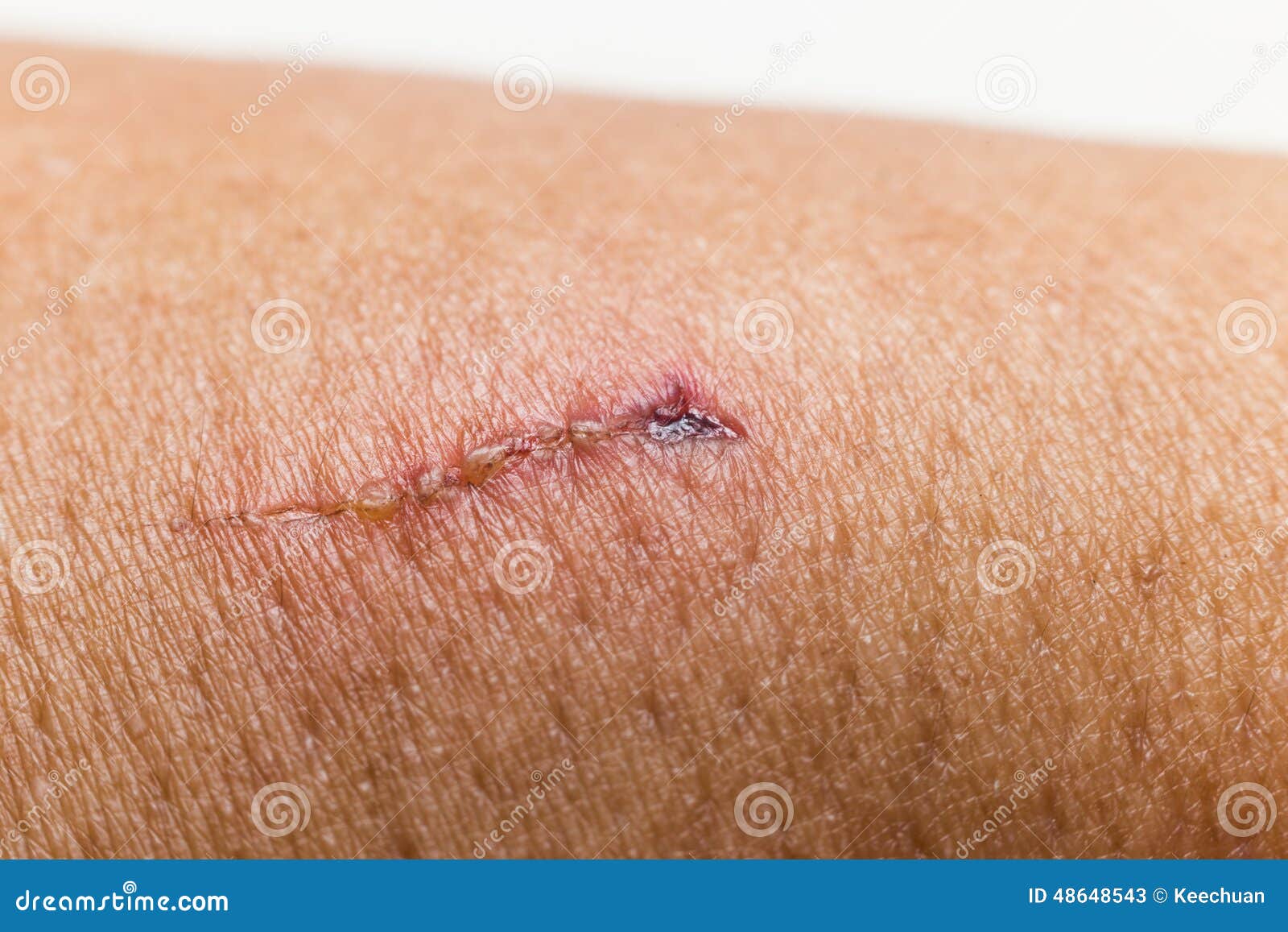Wound from a cut stock image. Image of patient, medicine - 48648543