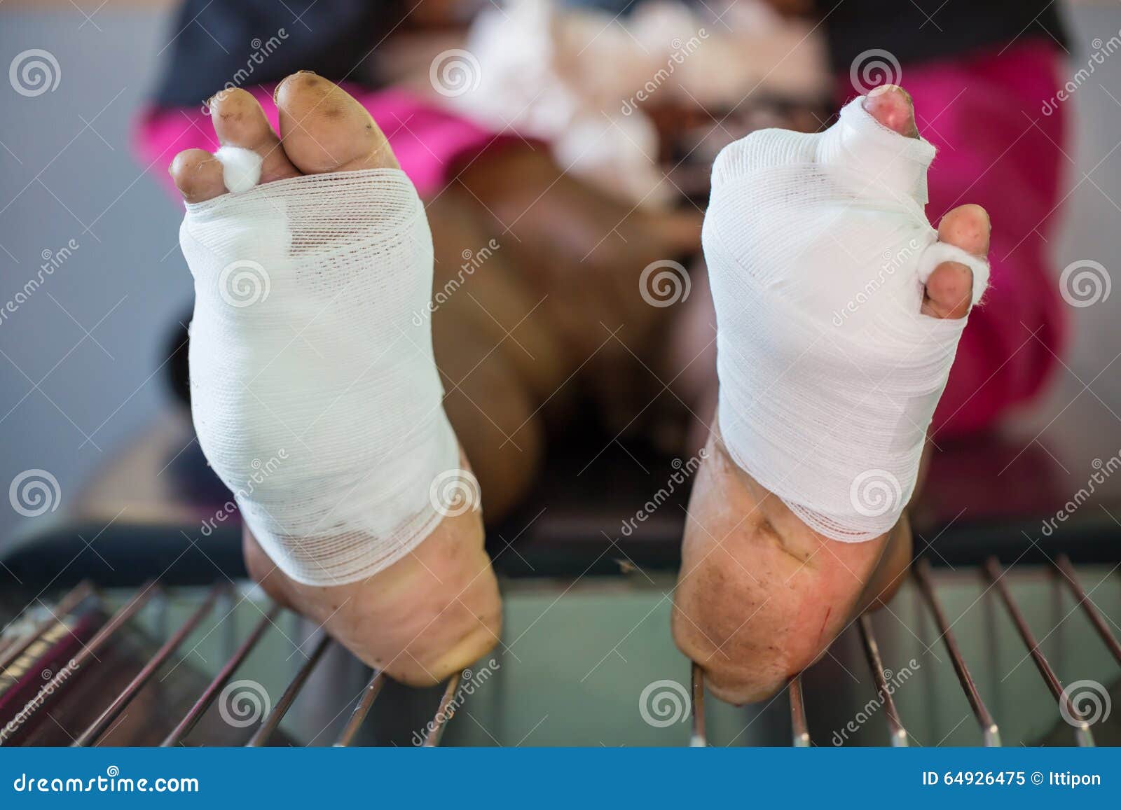 Wound of diabetic foot stock image. Image of hospital - 64926475