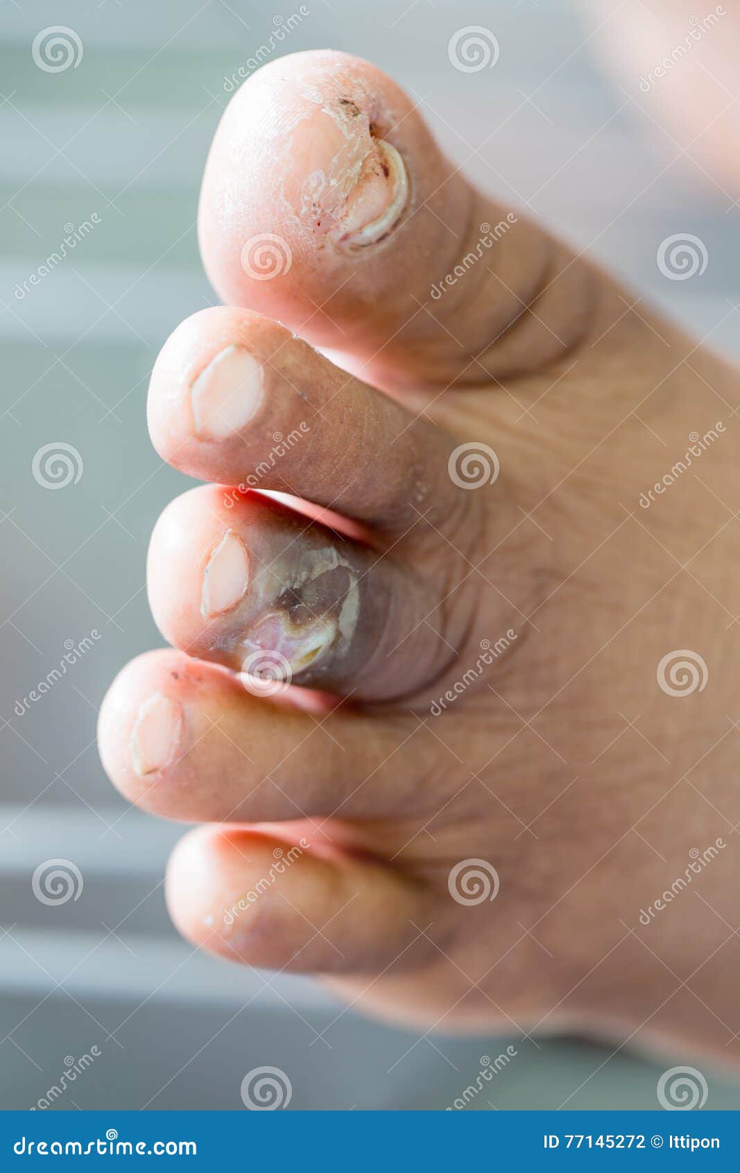 Wound of diabetic foot stock photo. Image of foot, heal - 77145272