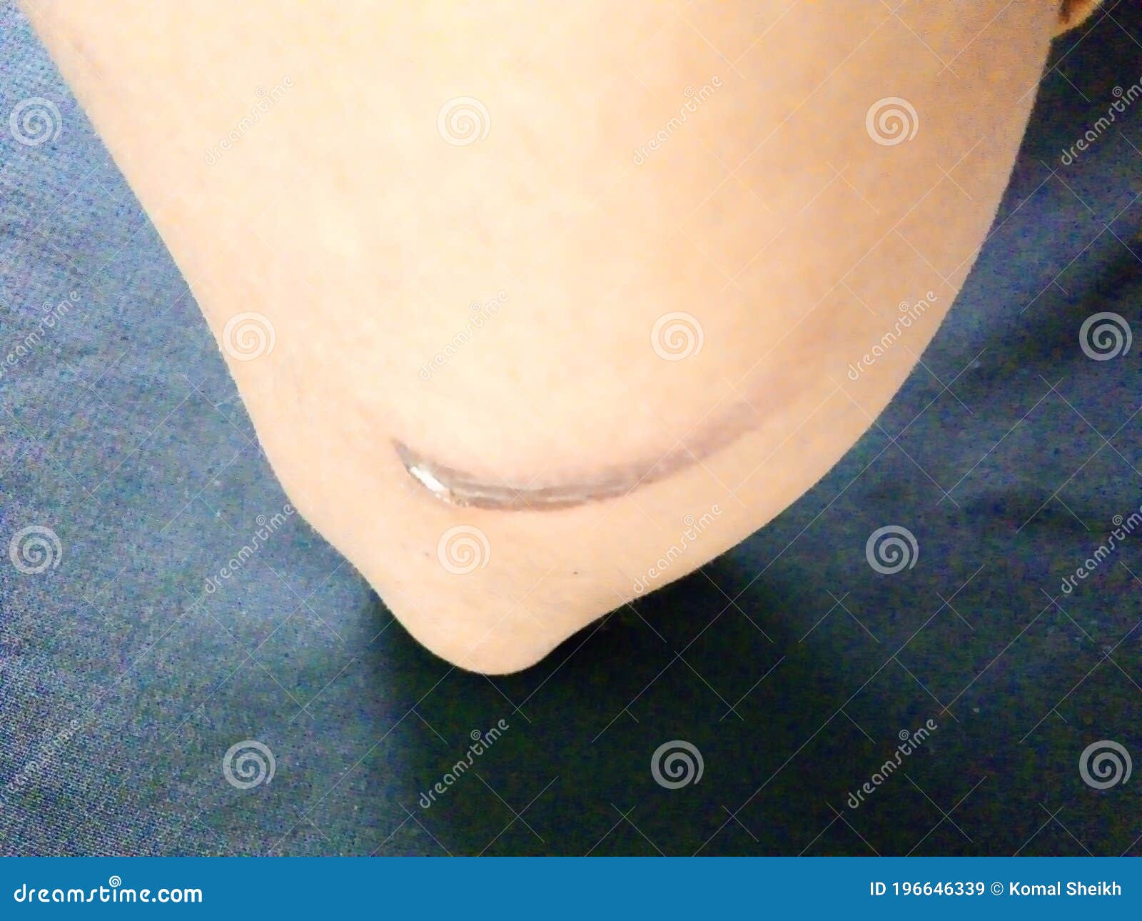 Wound in elbow burn mark stock image. Image of brown - 196646339