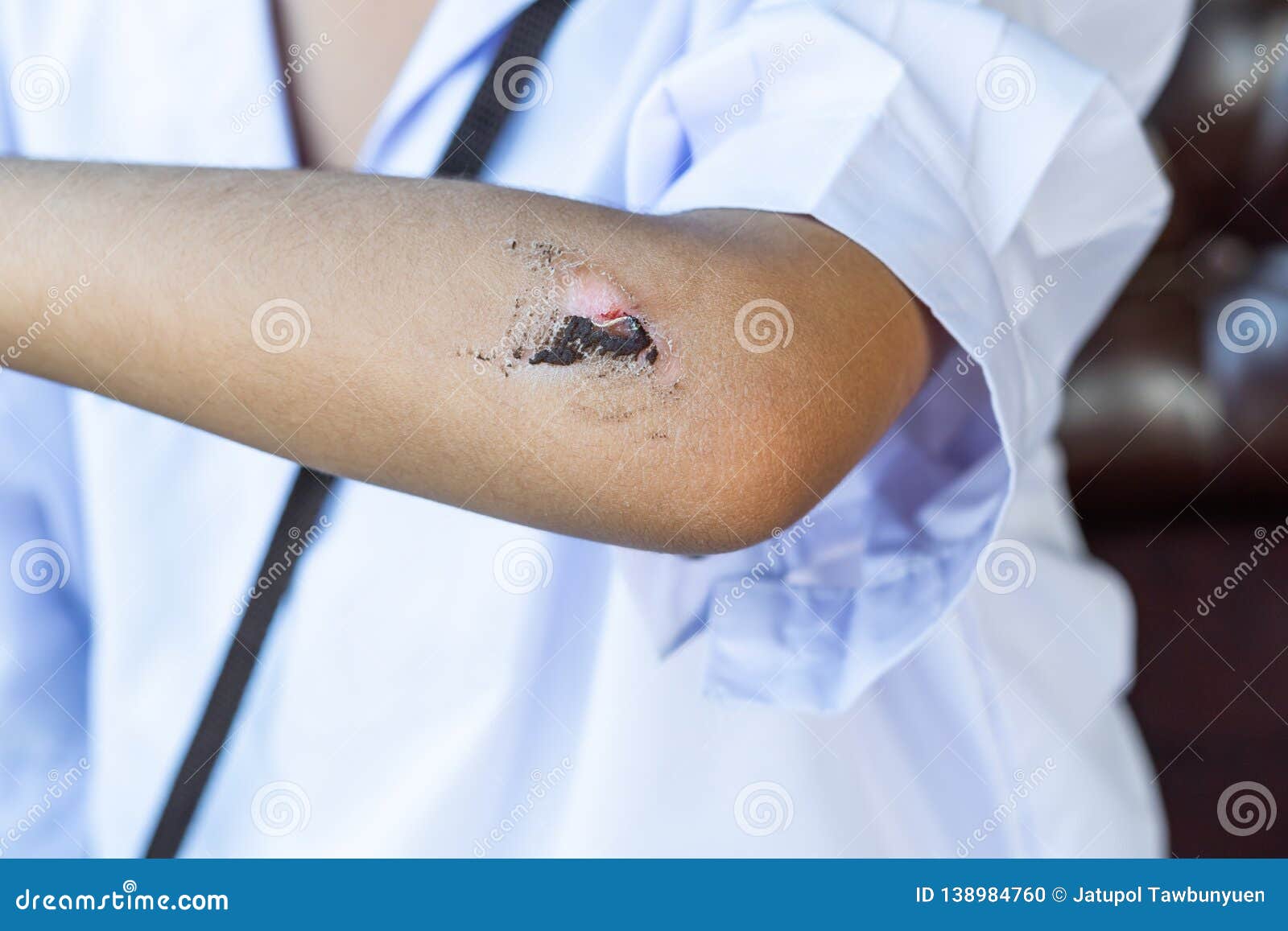 Wound Have Scab on the Elbow of the Child Stock Photo - Image of lesion ...