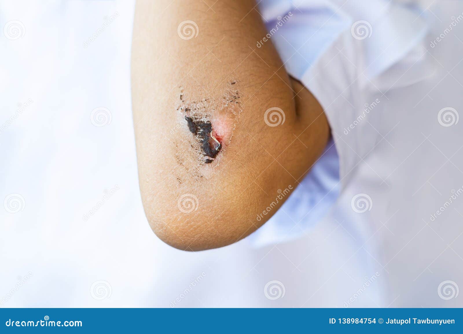 Wound Have Scab on the Elbow of the Child Stock Photo - Image of care ...