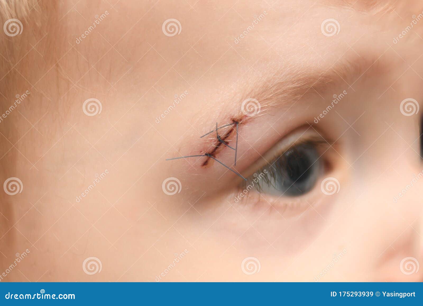 Wound on the Eyebrow of a Kid after a Bruise Stock Image - Image of ...