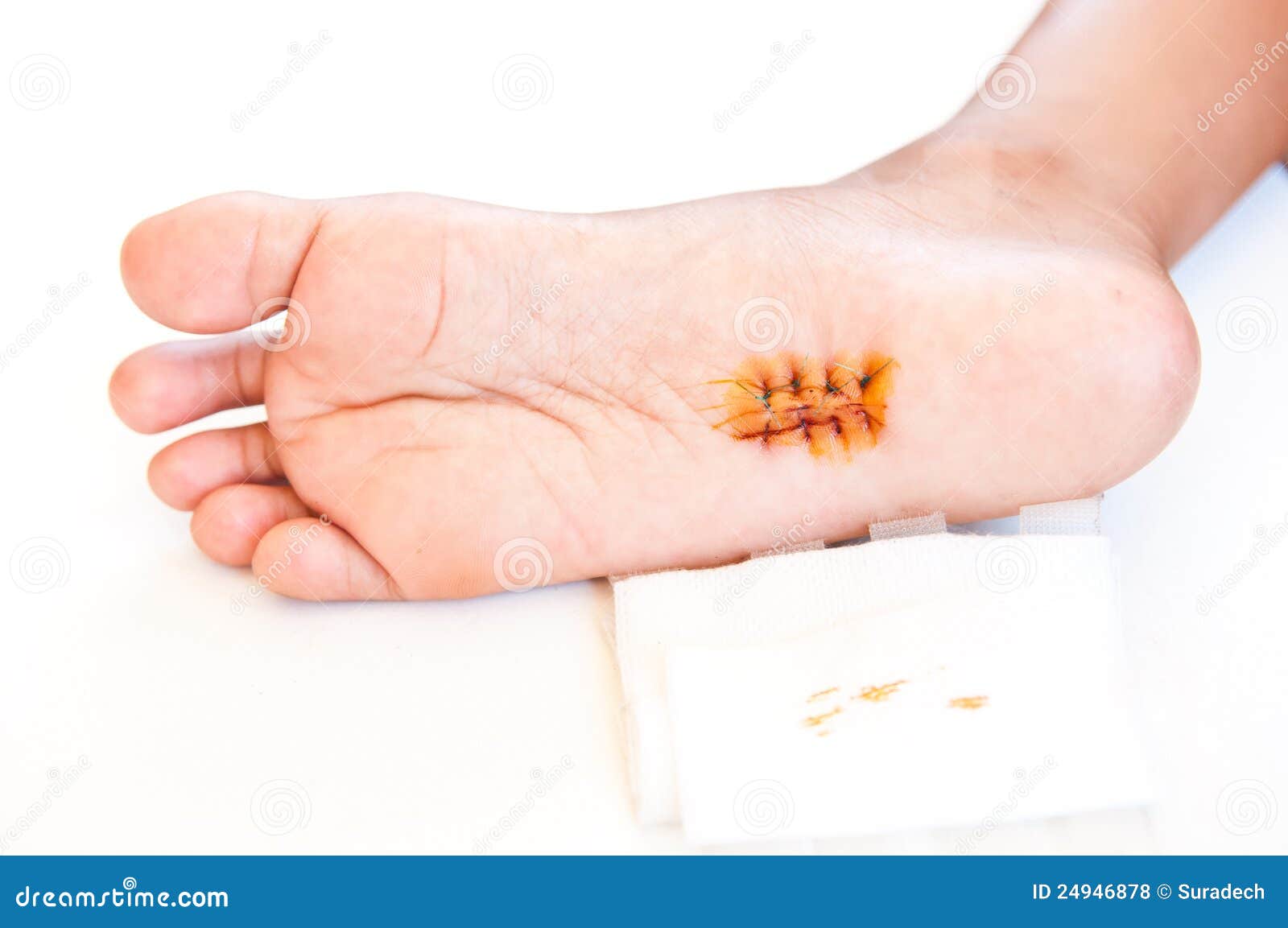 Wound On The Feet Stock Photo | CartoonDealer.com #24946878