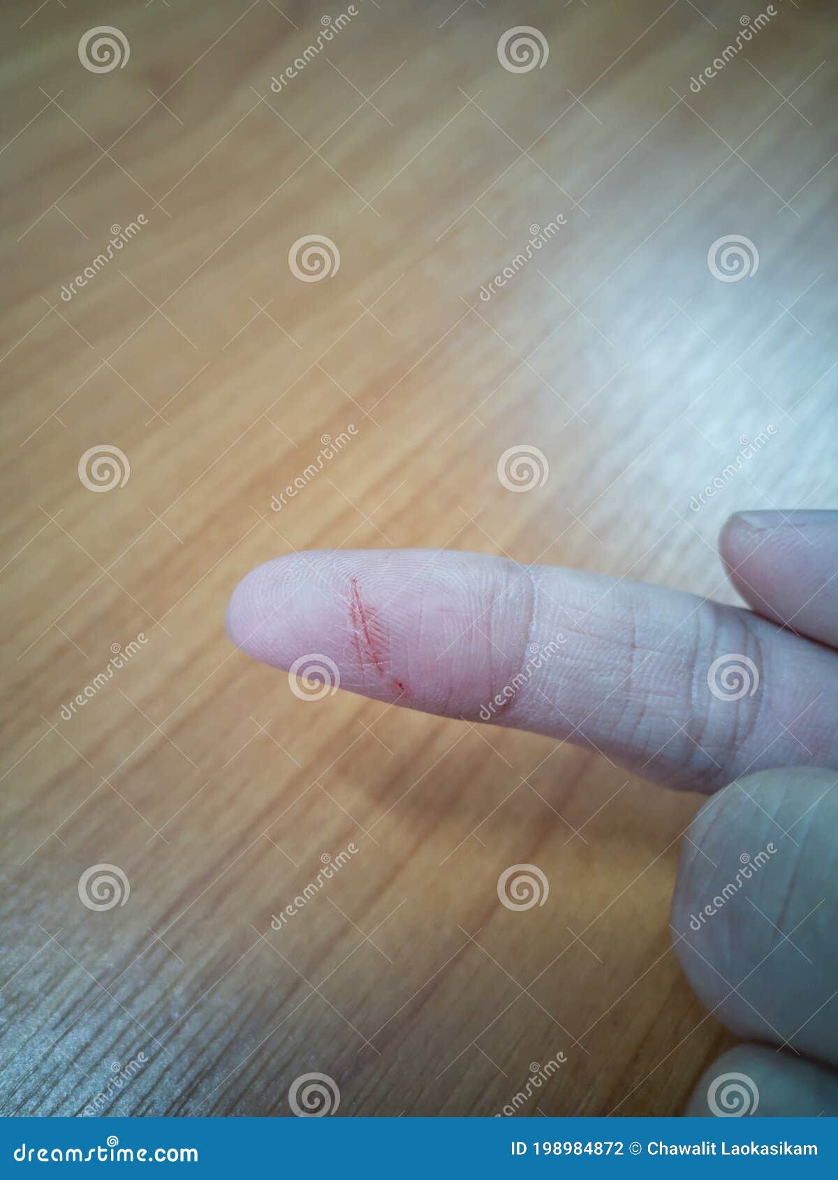 Wound on a Finger Caused by a Cut Stock Photo - Image of bleed, nail ...