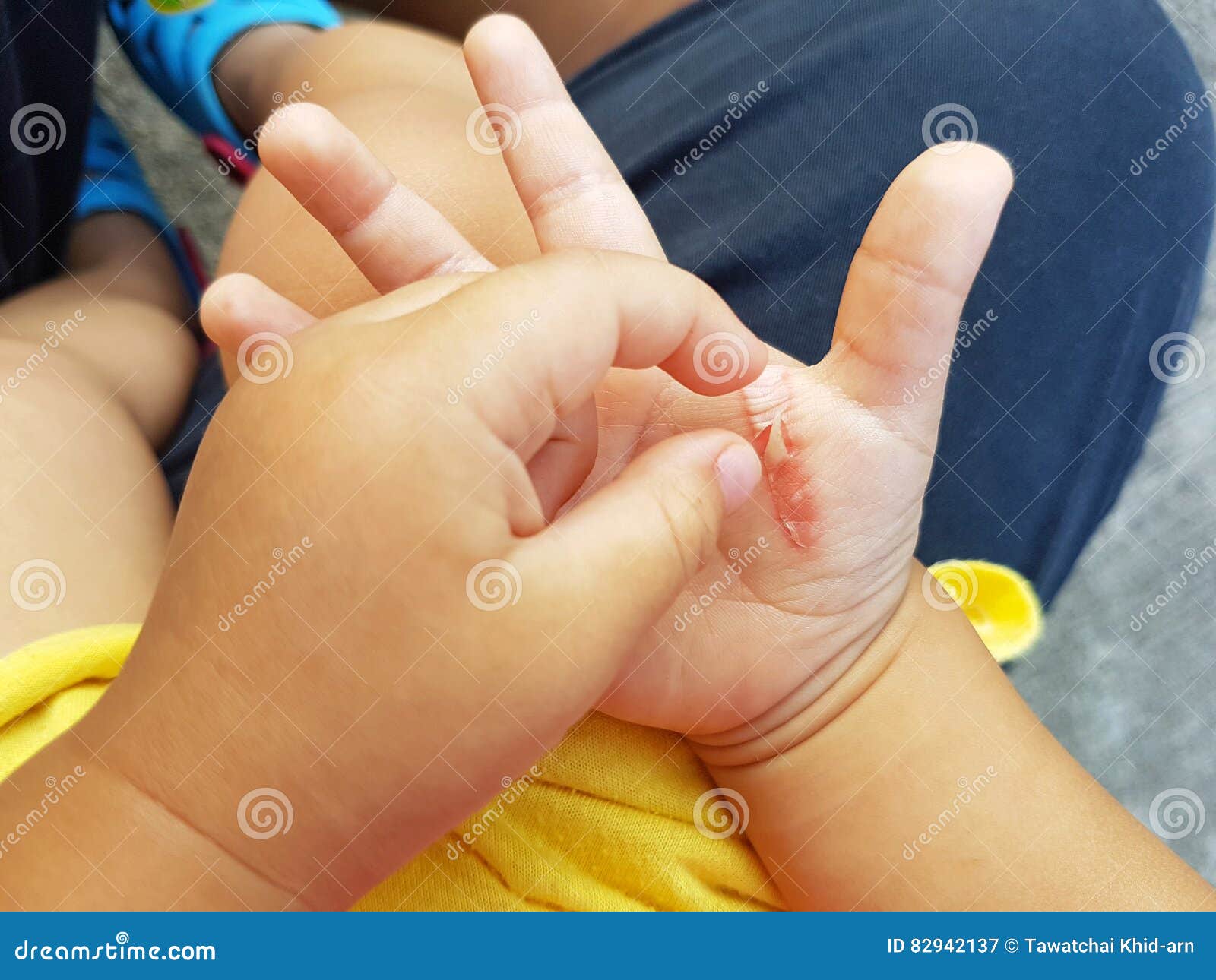Wound in the Hand of a Child from an Iron Burn. Stock Image - Image of ...