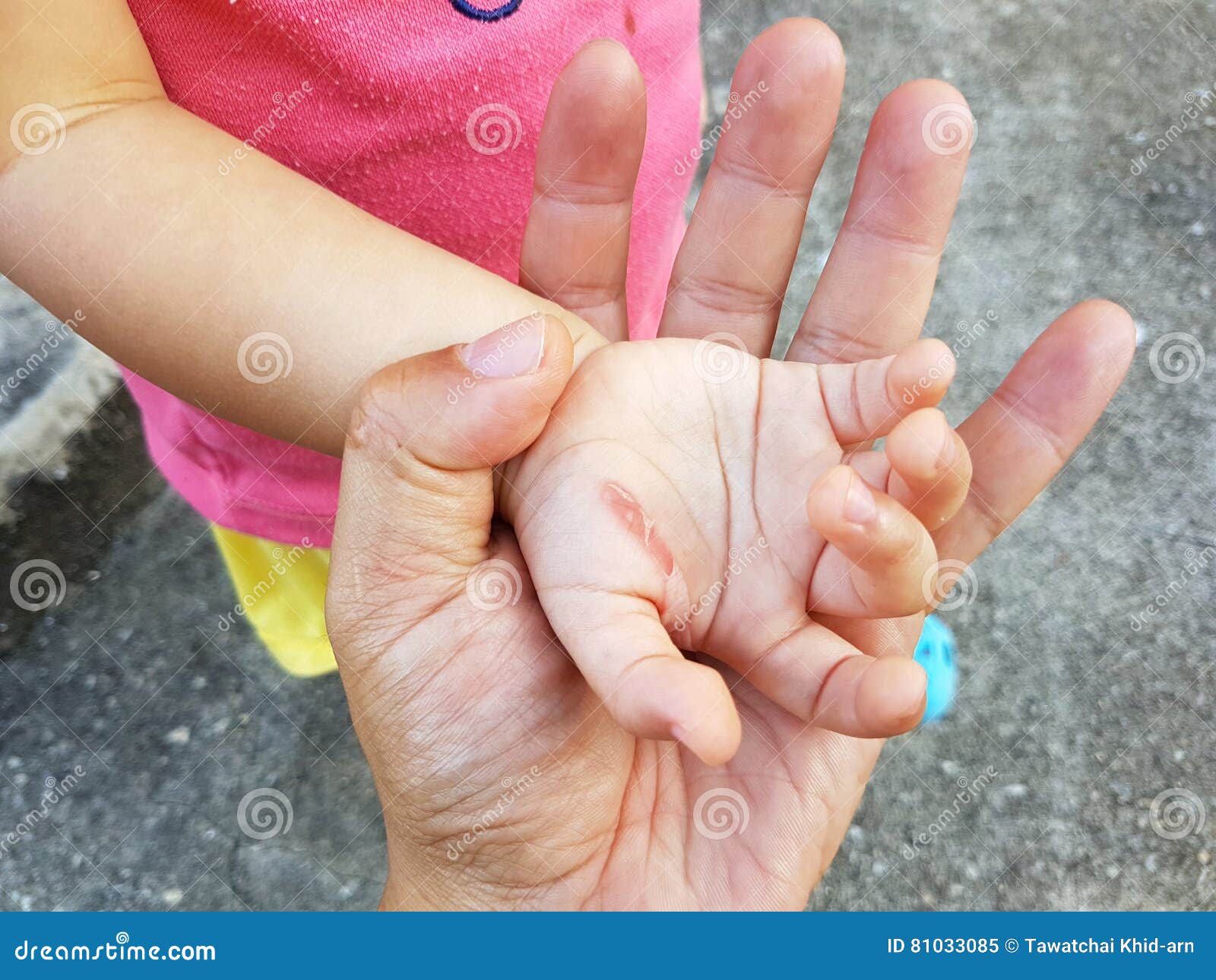 Wound in the Hand of a Child from an Iron Burn in Father`s Hand. Stock ...