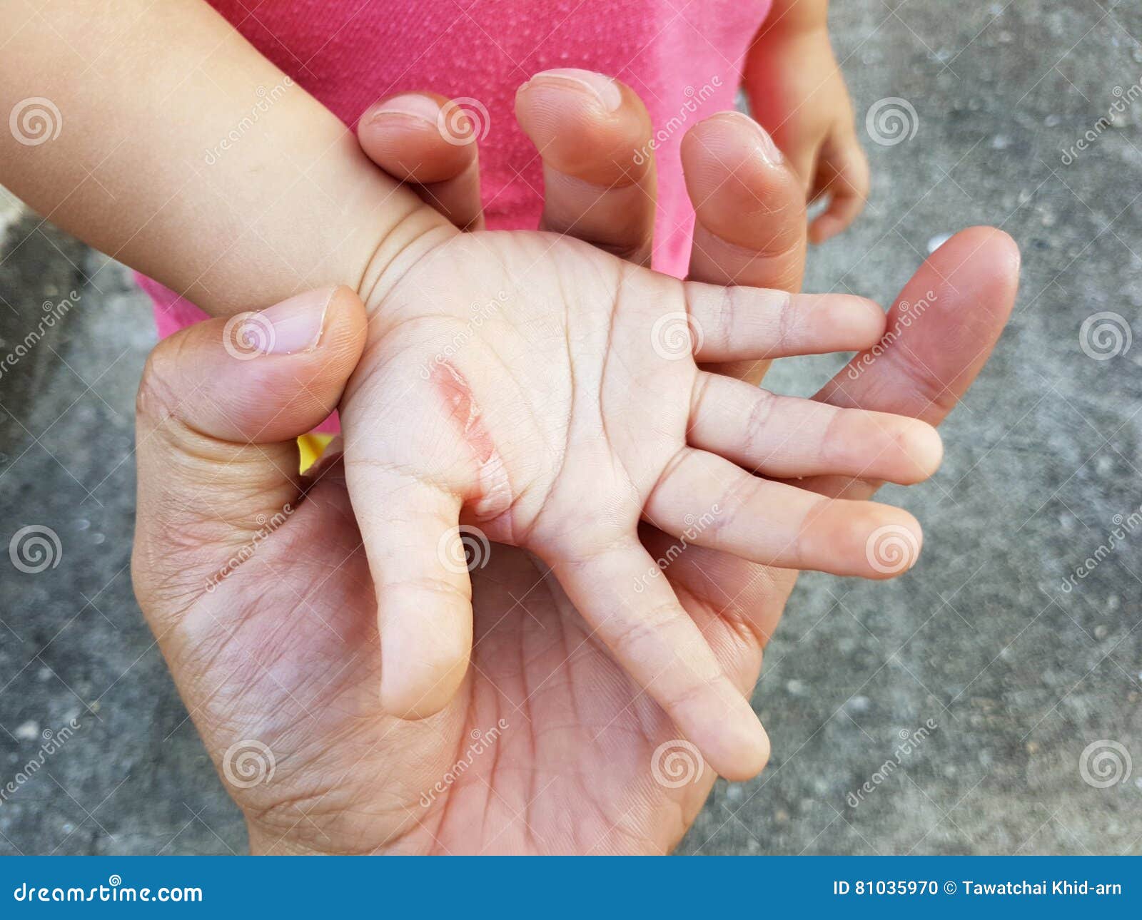 Wound in the Hand of a Child from an Iron Burn in Father`s Hand. Stock ...