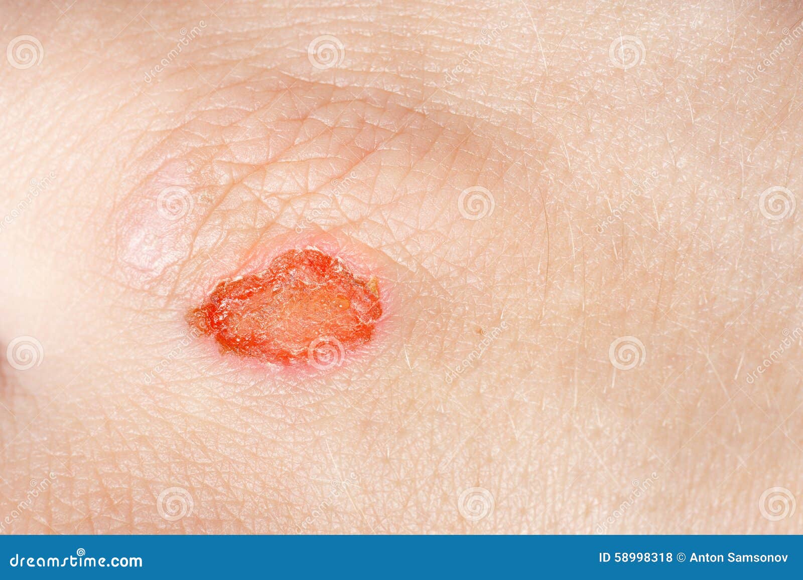 Wound stock photo. Image of care, harm, medicine, hand - 58998318