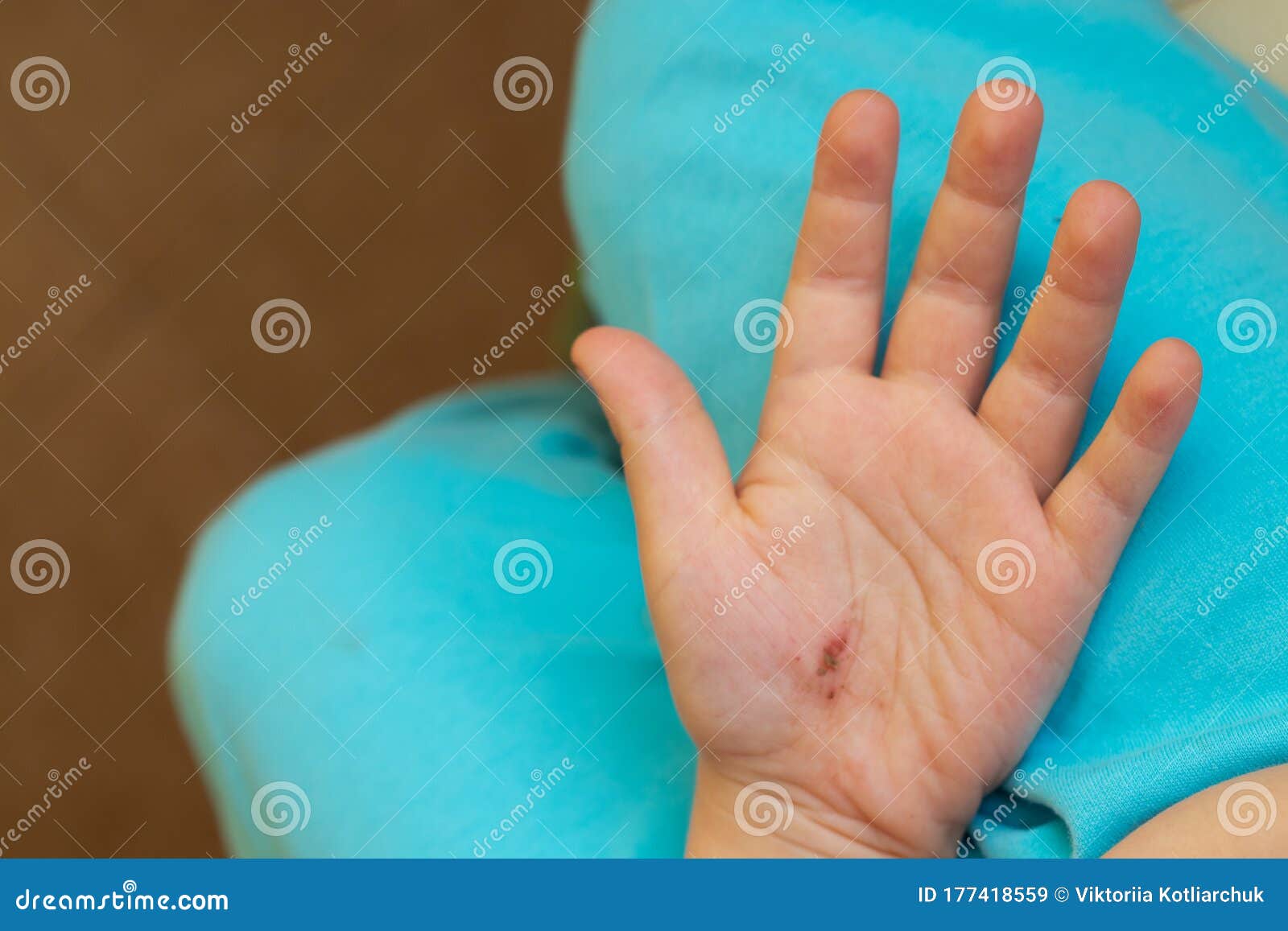 A Wound on the Hand of a Little Boy after Falling Stock Image - Image ...