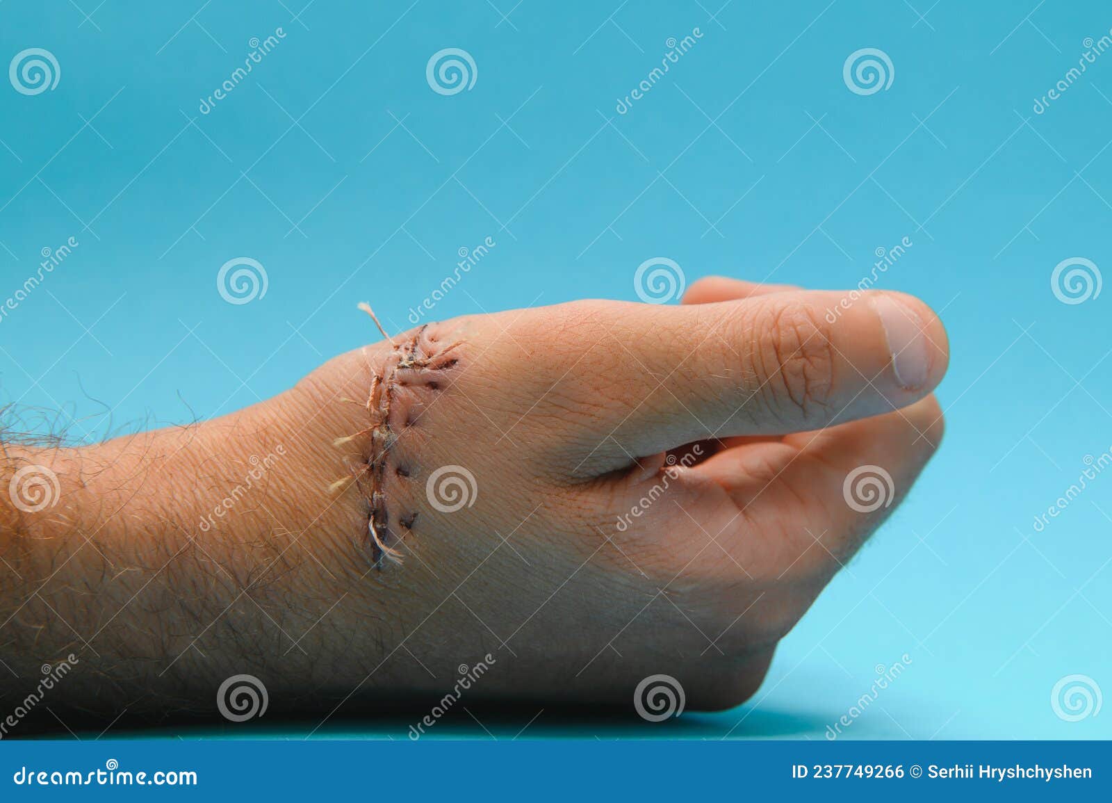 Wound Hand, Suturing the Wound. the Type of Cut after Surgery Stock ...