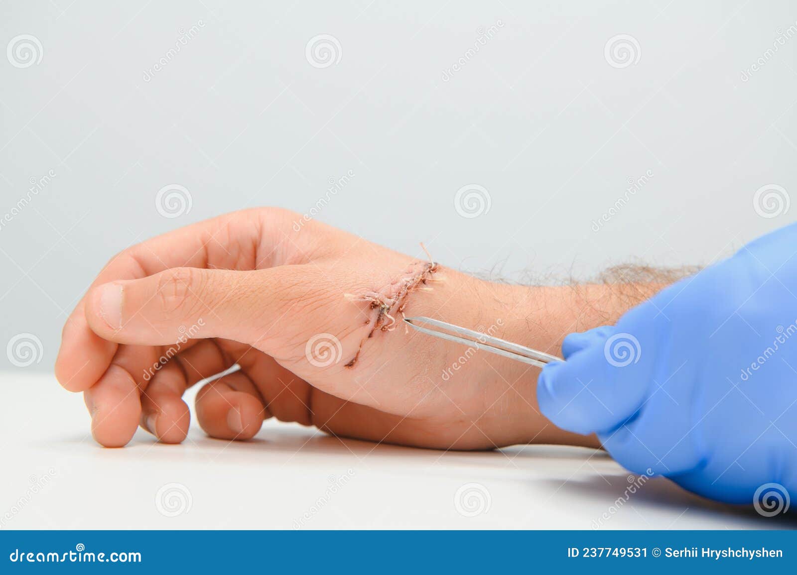 Wound Hand, Suturing the Wound. the Type of Cut after Surgery Stock ...