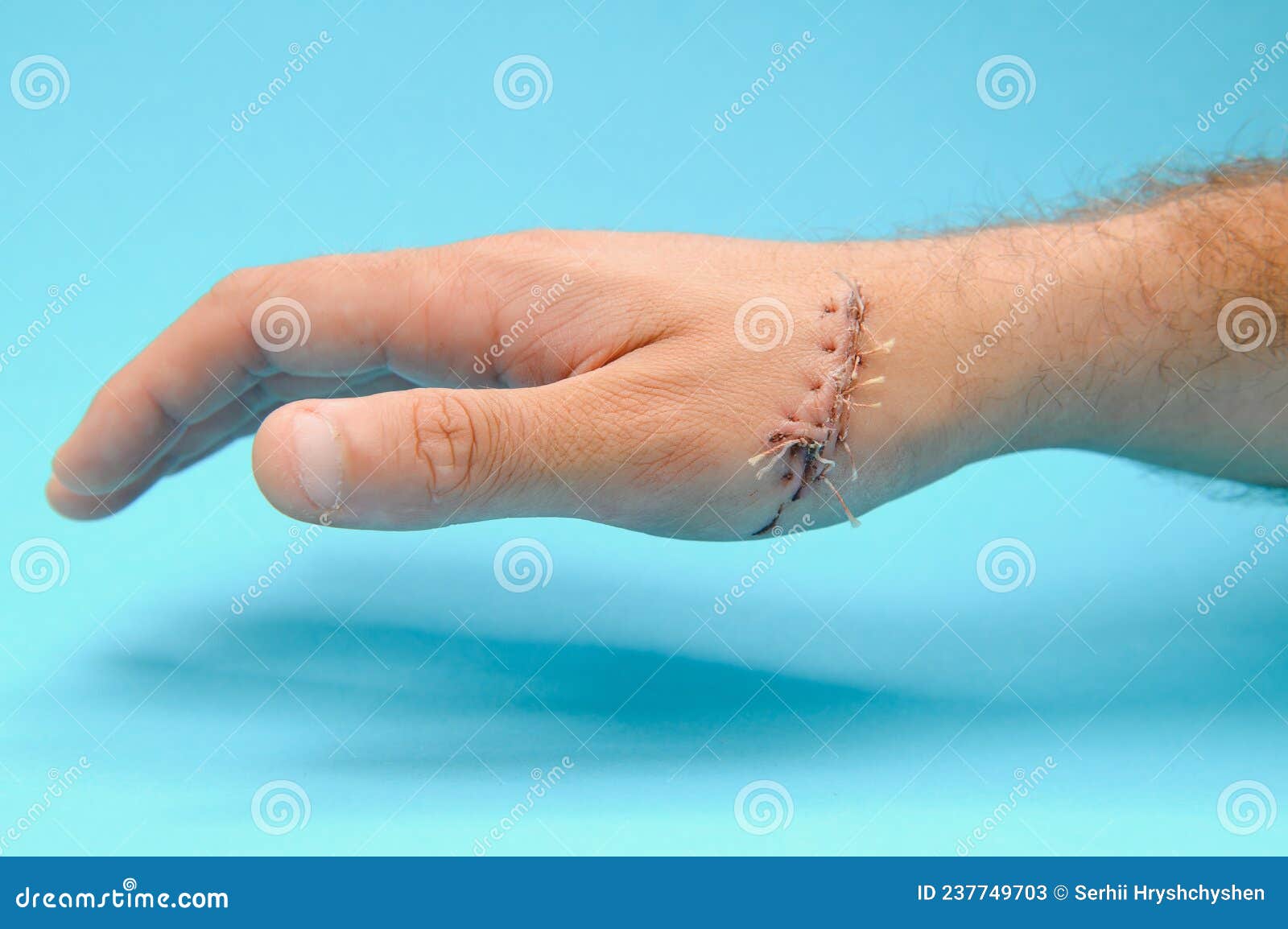 Wound Hand, Suturing the Wound. the Type of Cut after Surgery Stock ...