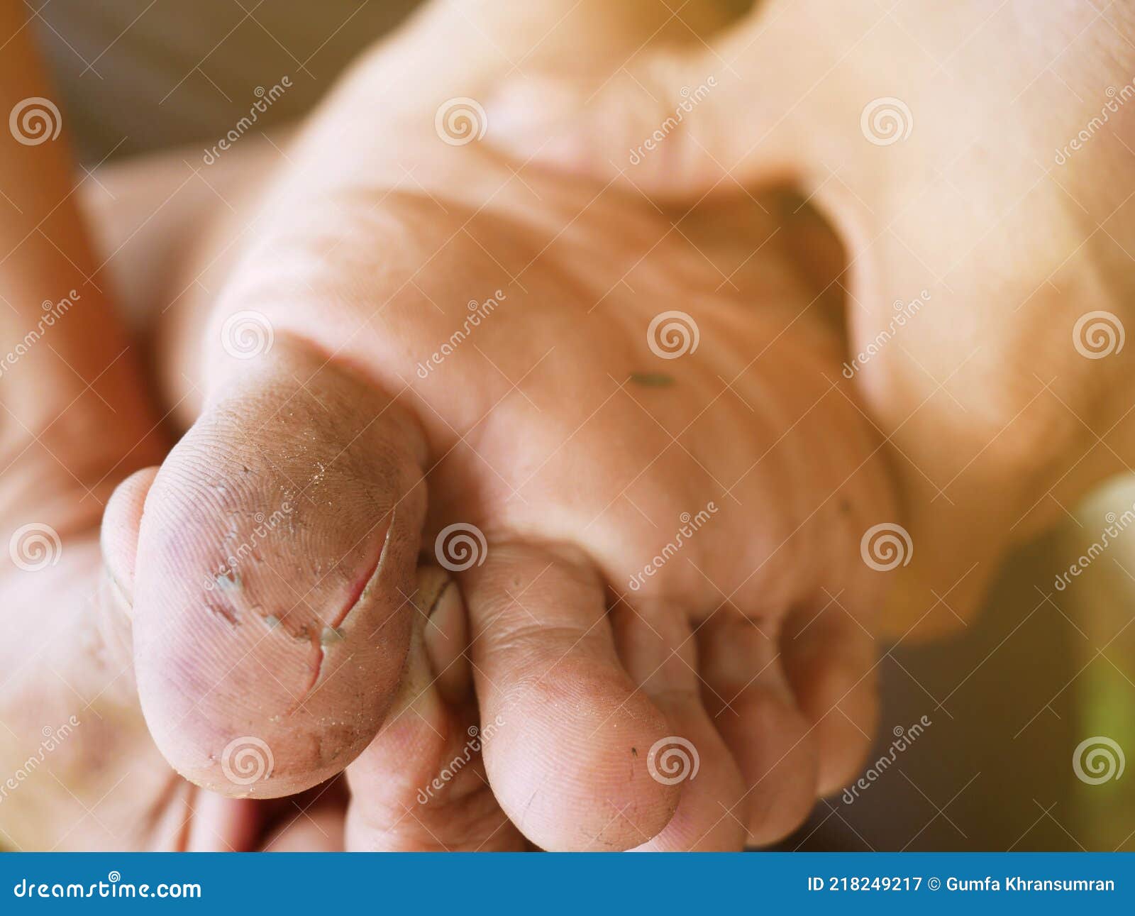 A Wound that Has Been Cut by a Sharp Object Stock Image - Image of ...