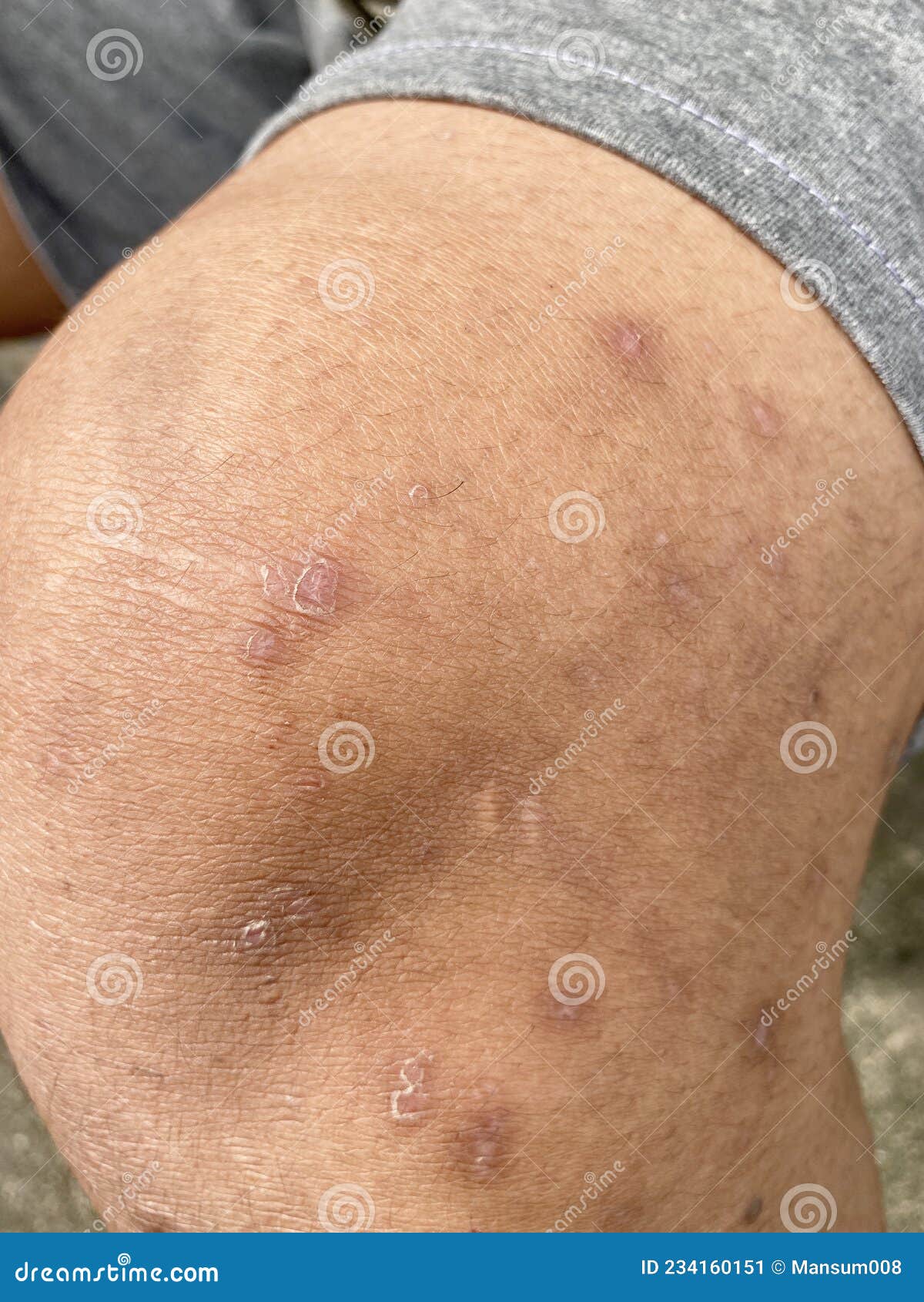 Wound on his leg stock image. Image of lesion, health - 234160151