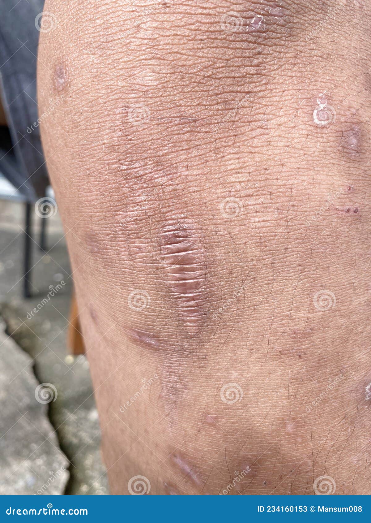 Wound on his leg stock image. Image of scar, illness - 234160153