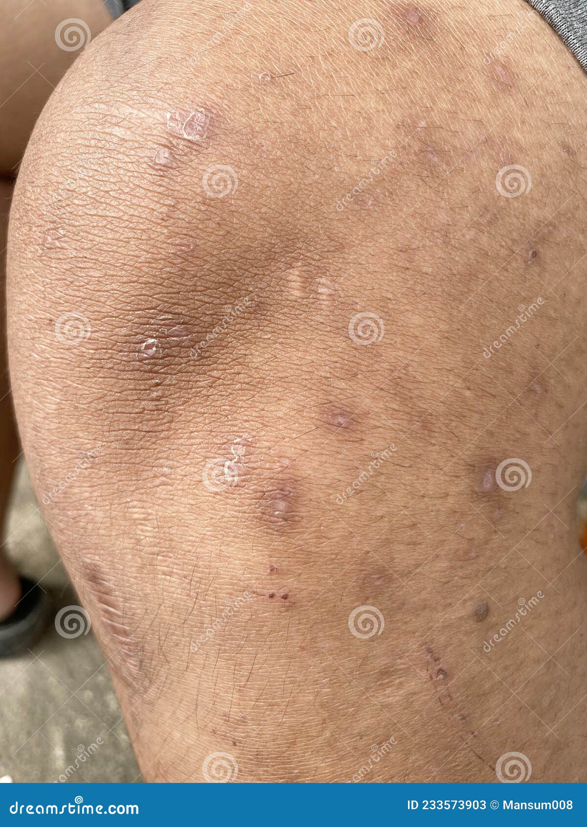 Wound on his leg stock image. Image of ugly, illness - 233573903
