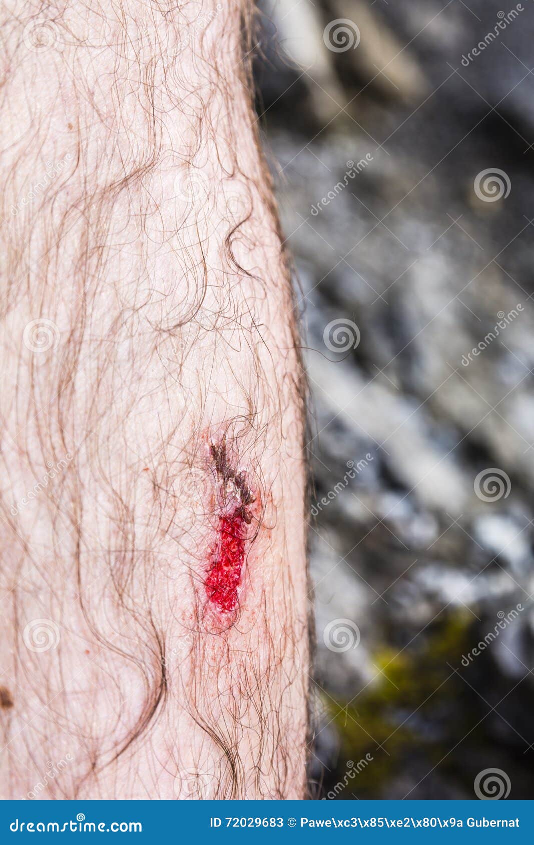 Wound on his leg. stock image. Image of crusta, scab - 72029683