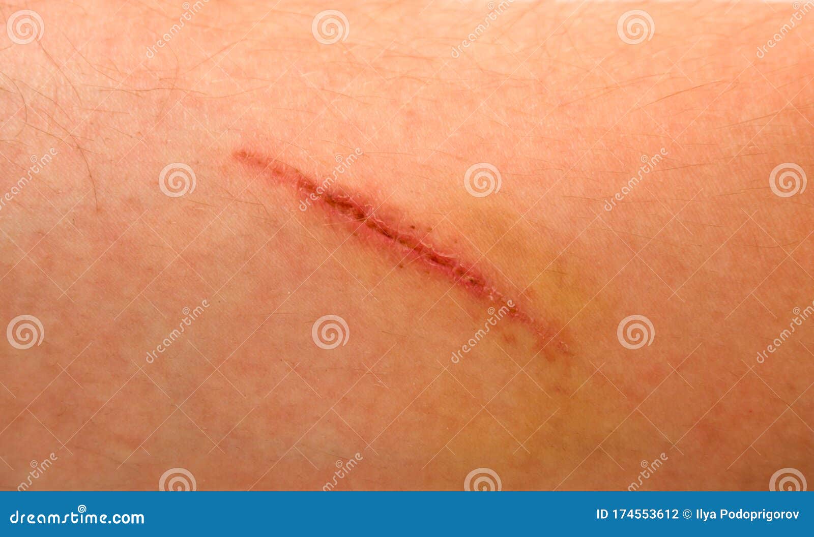 A Wound on the Human Body, Suture Old, Deep Cut, Scar Close-up ...