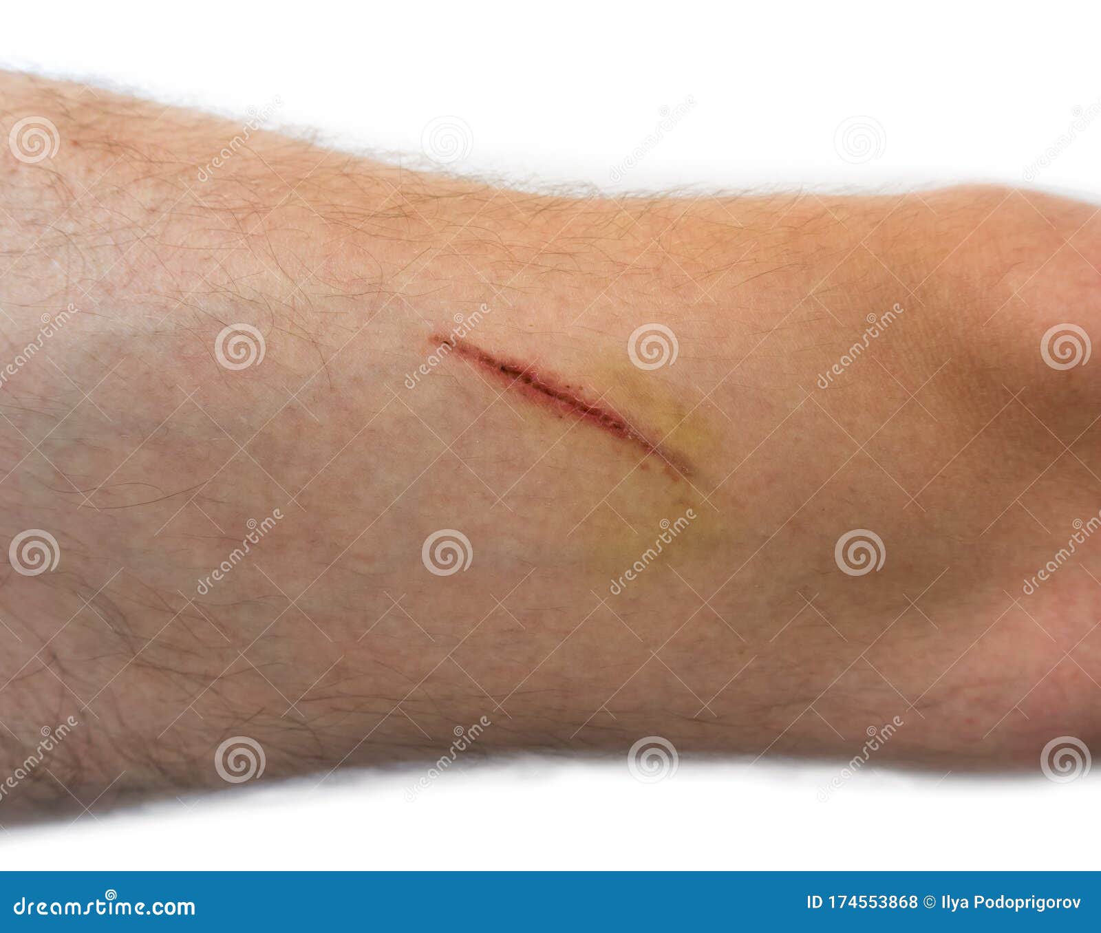 Stitched Wound Against White Background