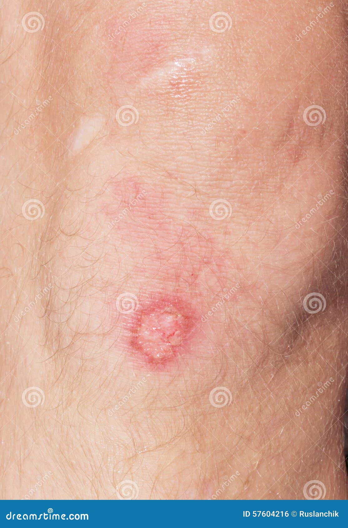Wound stock photo. Image of pain, closeup, scab, person - 57604216