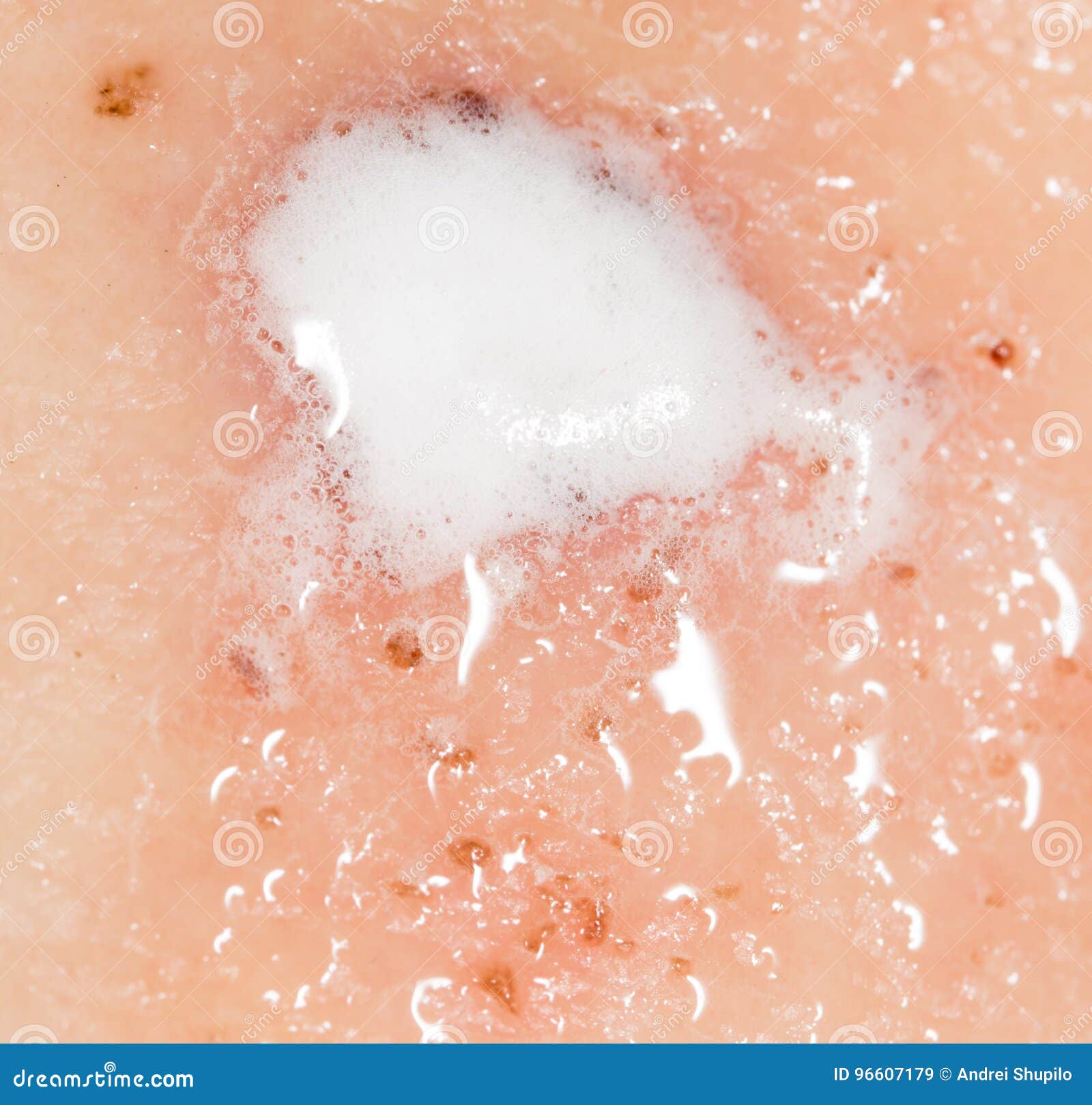Wound on Human Skin in Hydrogen Peroxide Stock Image - Image of pain ...
