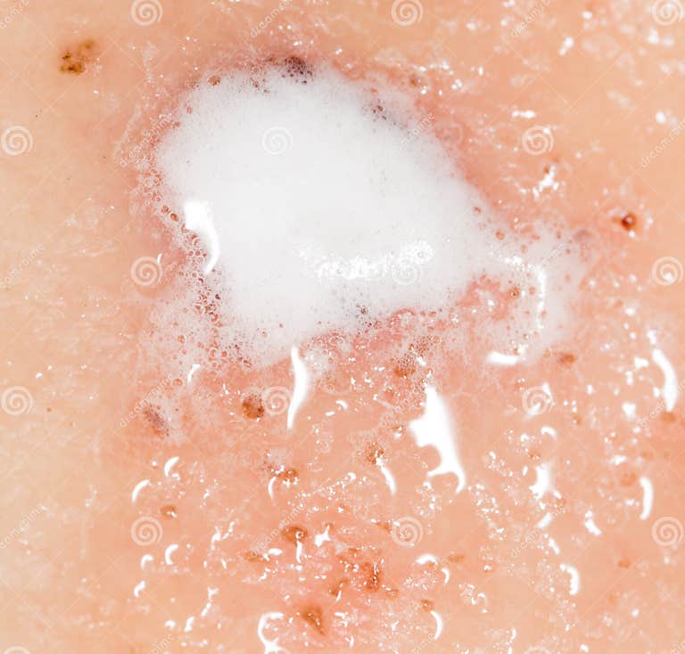 Wound on Human Skin in Hydrogen Peroxide Stock Image - Image of pain ...