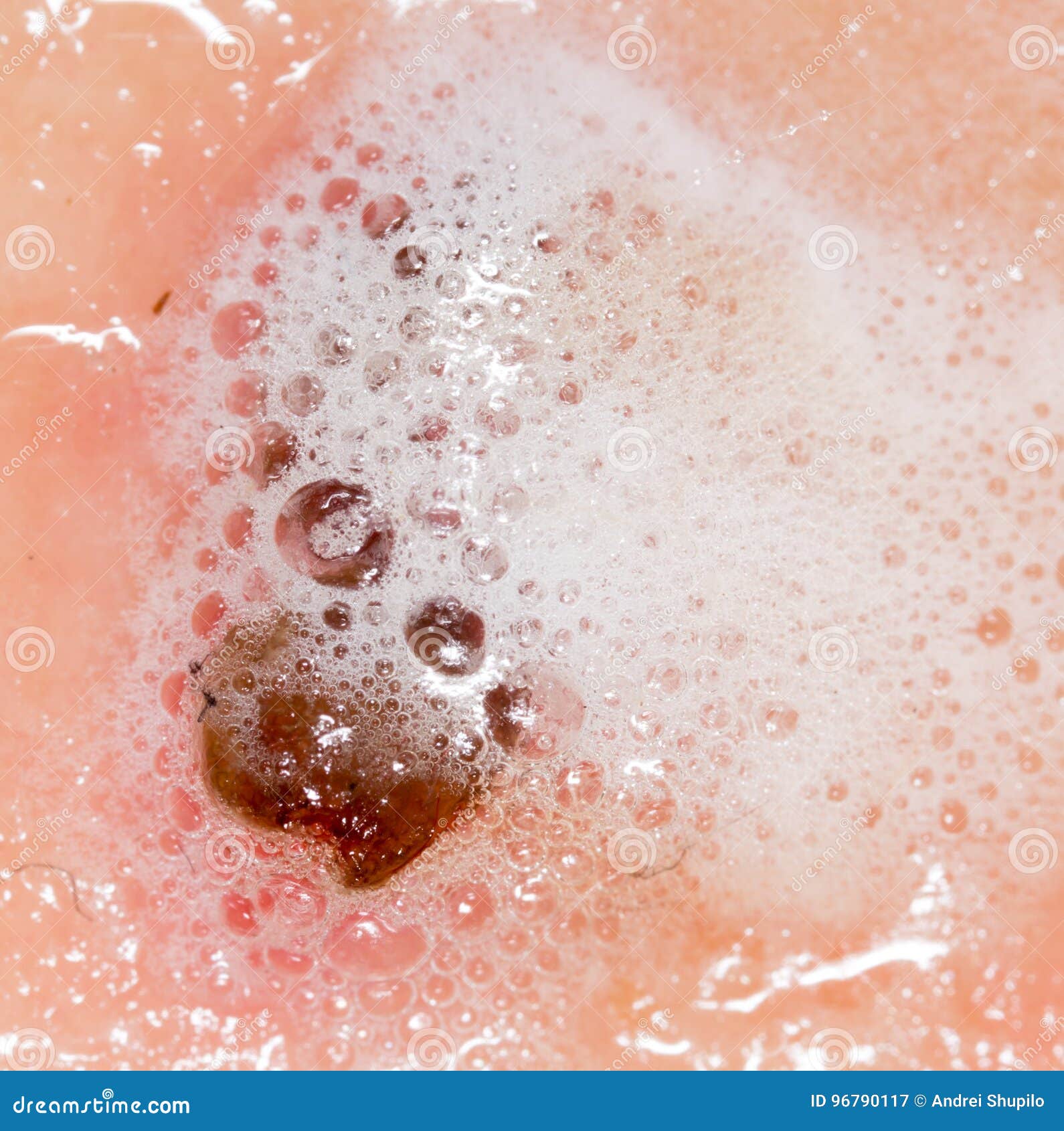 Wound on Human Skin in Hydrogen Peroxide Stock Image - Image of hand ...