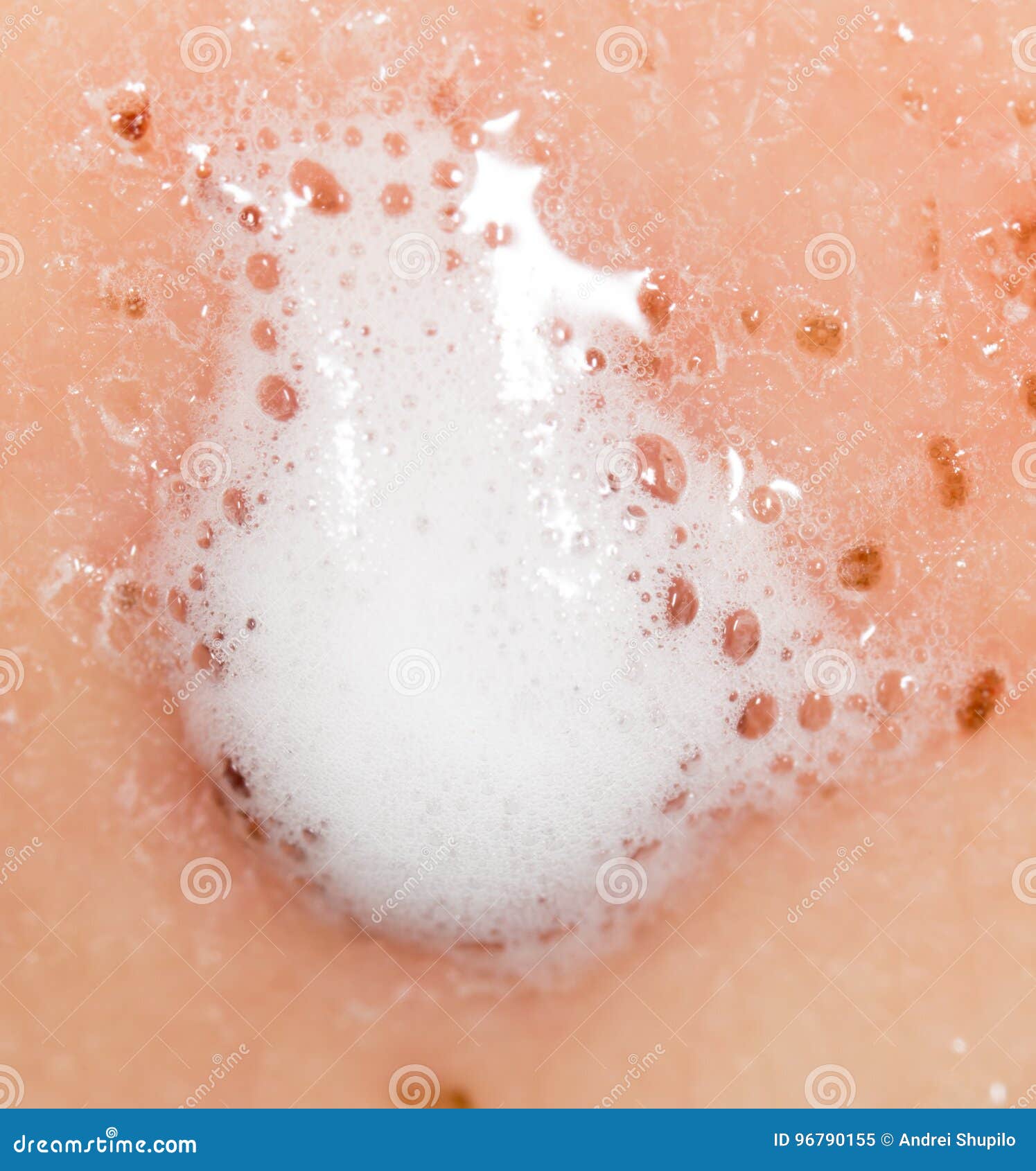 Wound on Human Skin in Hydrogen Peroxide Stock Image - Image of ...