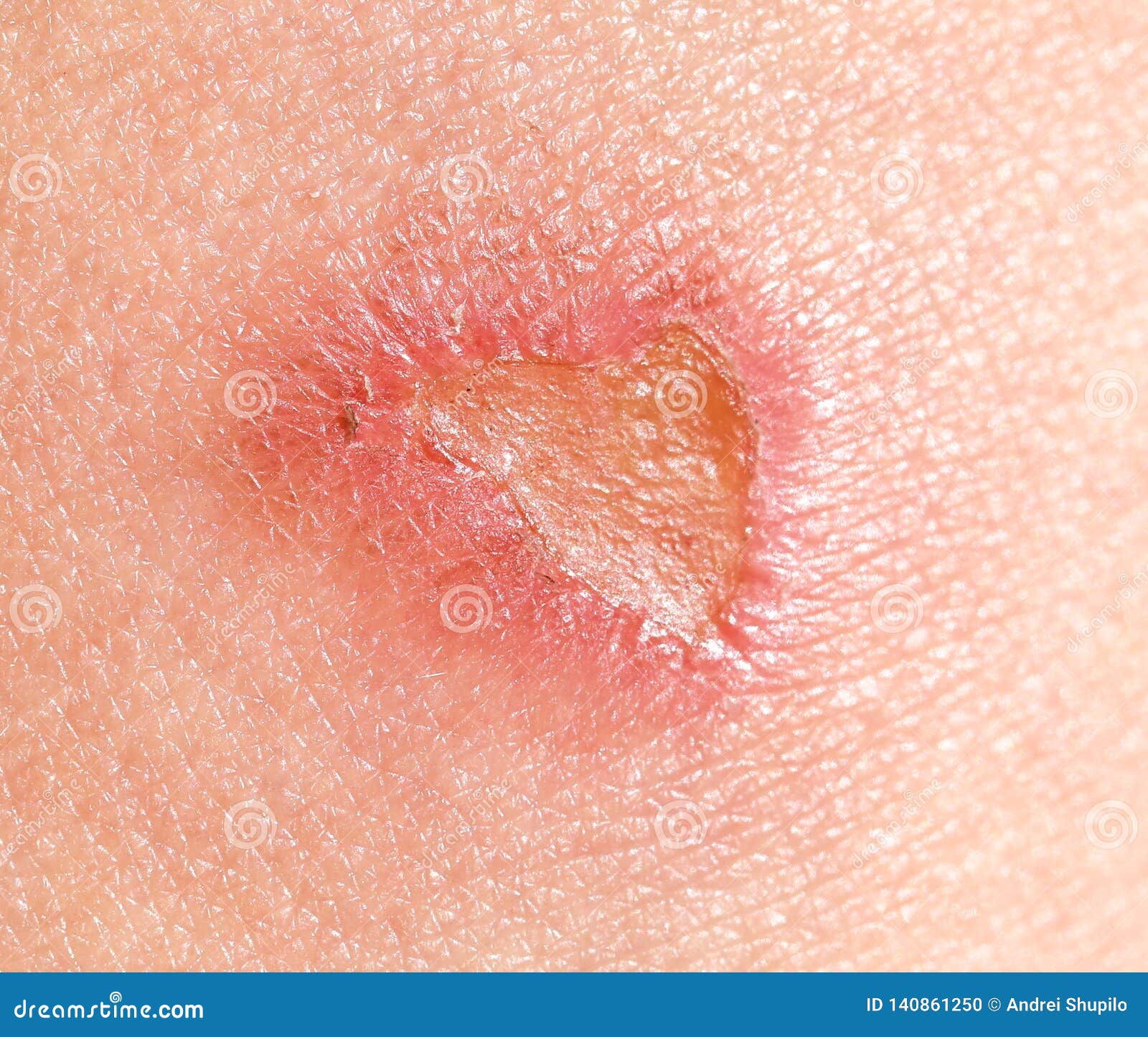 Wound on human skin. stock photo. Image of injured, texture - 140861250