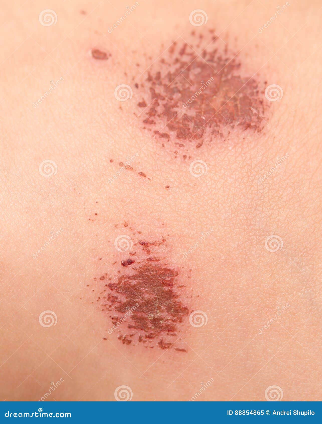 Wound in human skin stock image. Image of recovery, bloody - 88854865