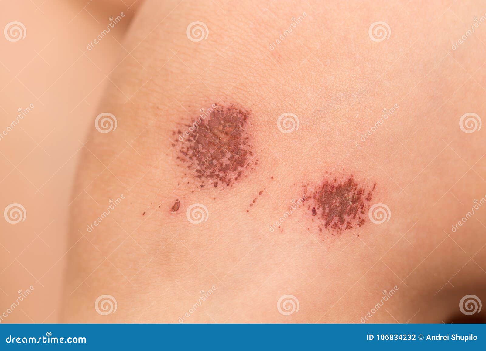 Wound in human skin stock photo. Image of effect, inflammation - 106834232