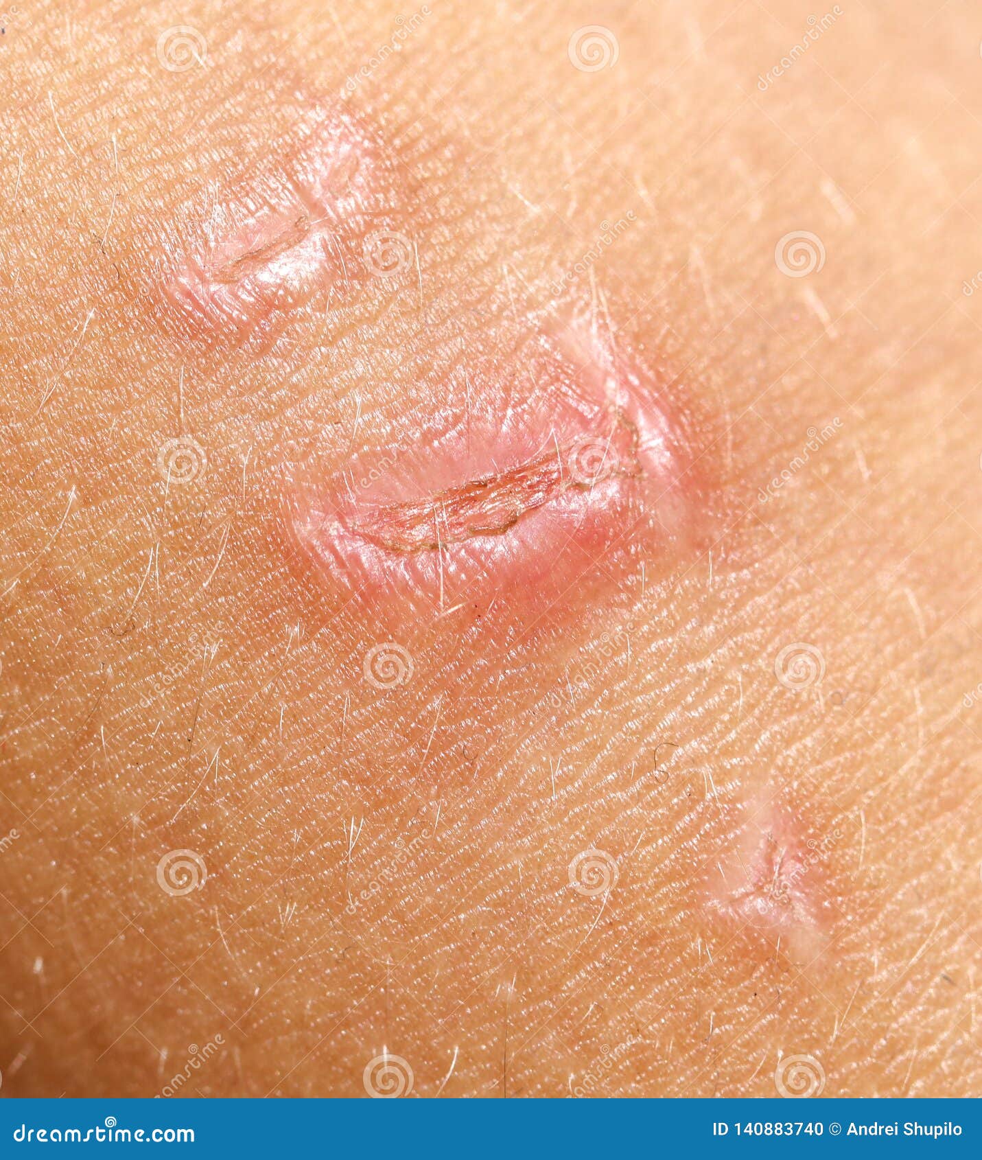 Wound on human skin. stock photo. Image of wound, bleed - 140883740