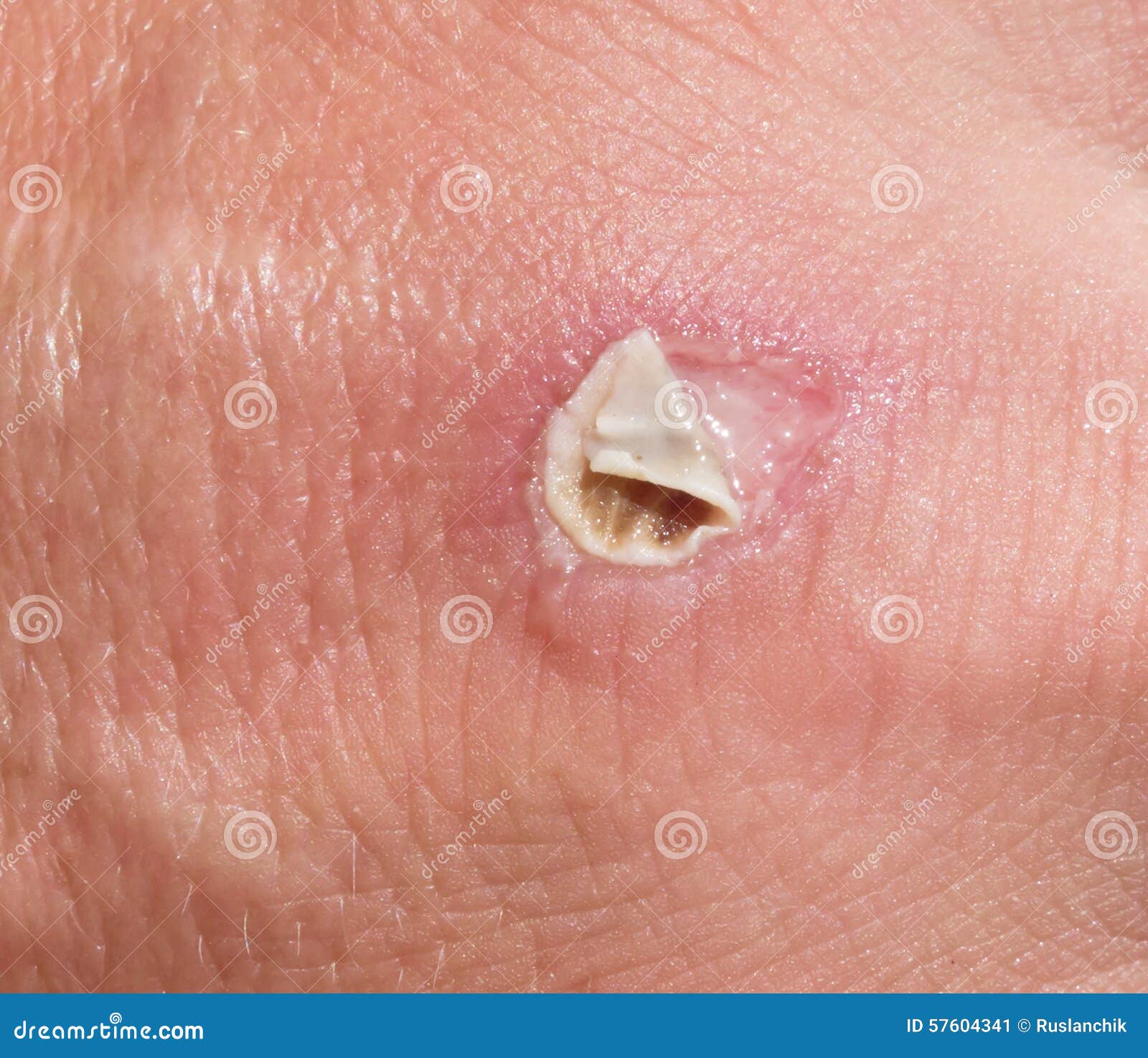 Wound stock image. Image of bleed, scratch, wound, medicine - 57604341