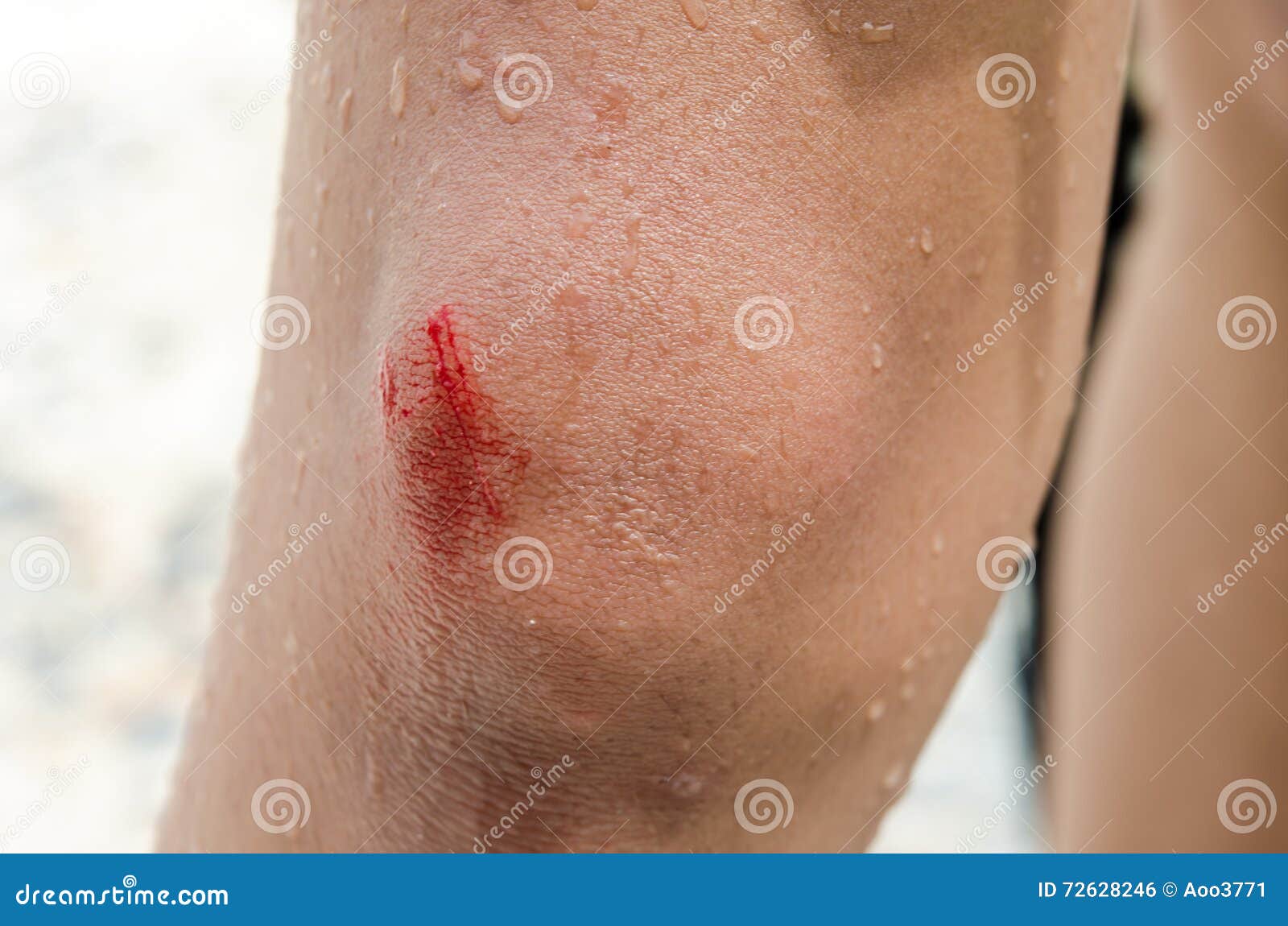 Wound Knee stock photo. Image of knee, blood, pain, infection - 72628246