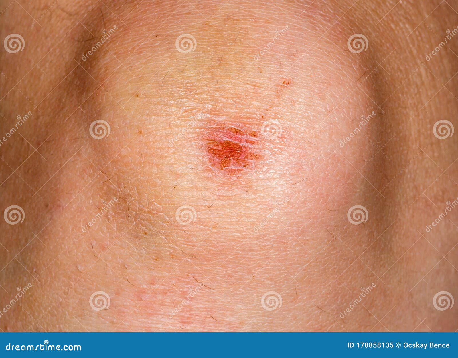 Wound On A Knee Of The Child Royalty-Free Stock Photography ...