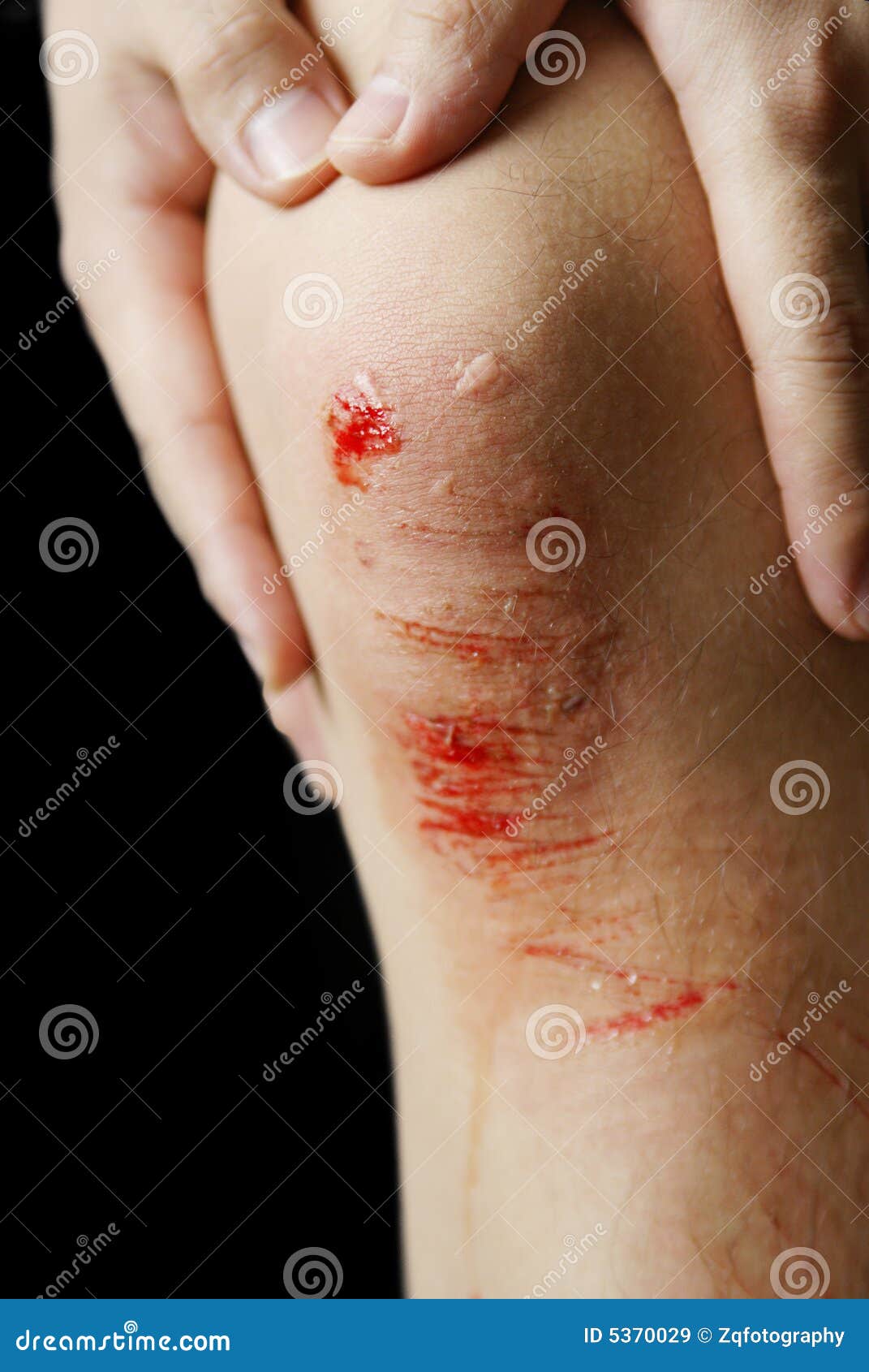Wound Leg stock image. Image of wound, cure, black, appeasement - 5370029