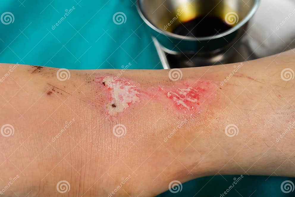 Wound on Leg after Cleaning, Injuries from Falling Stock Photo - Image ...