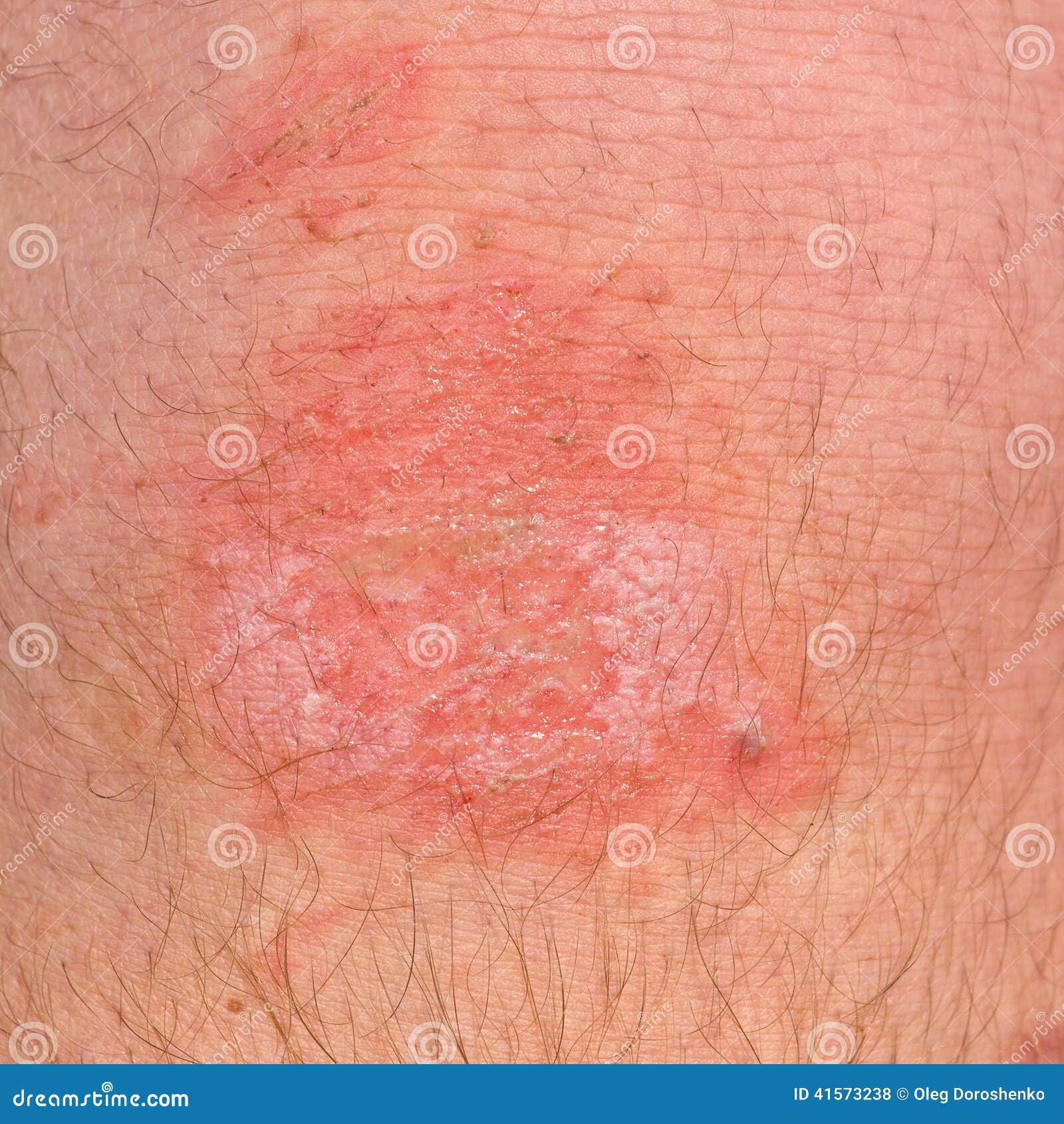 The wound on the leg stock photo. Image of medicine, distress - 41573238