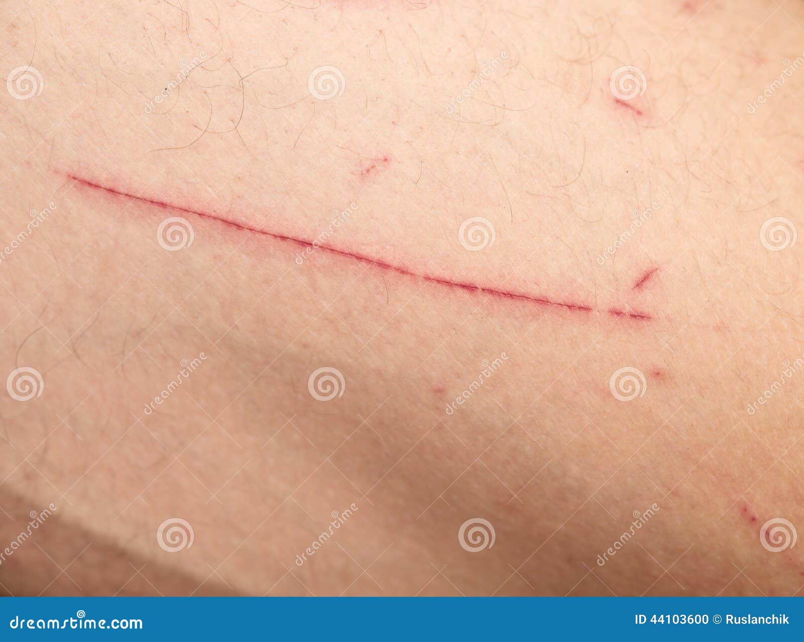 Wound stock photo. Image of close, health, hand, accident - 44103600