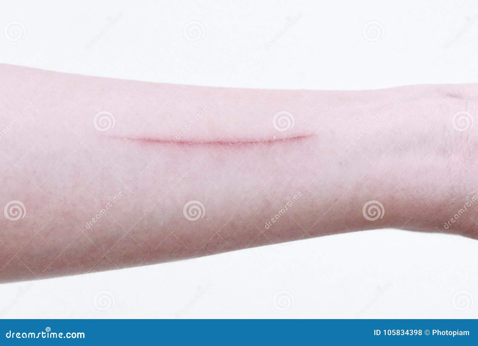 The Wound from Scratch on the Arm is Long. Stock Photo - Image of skin ...
