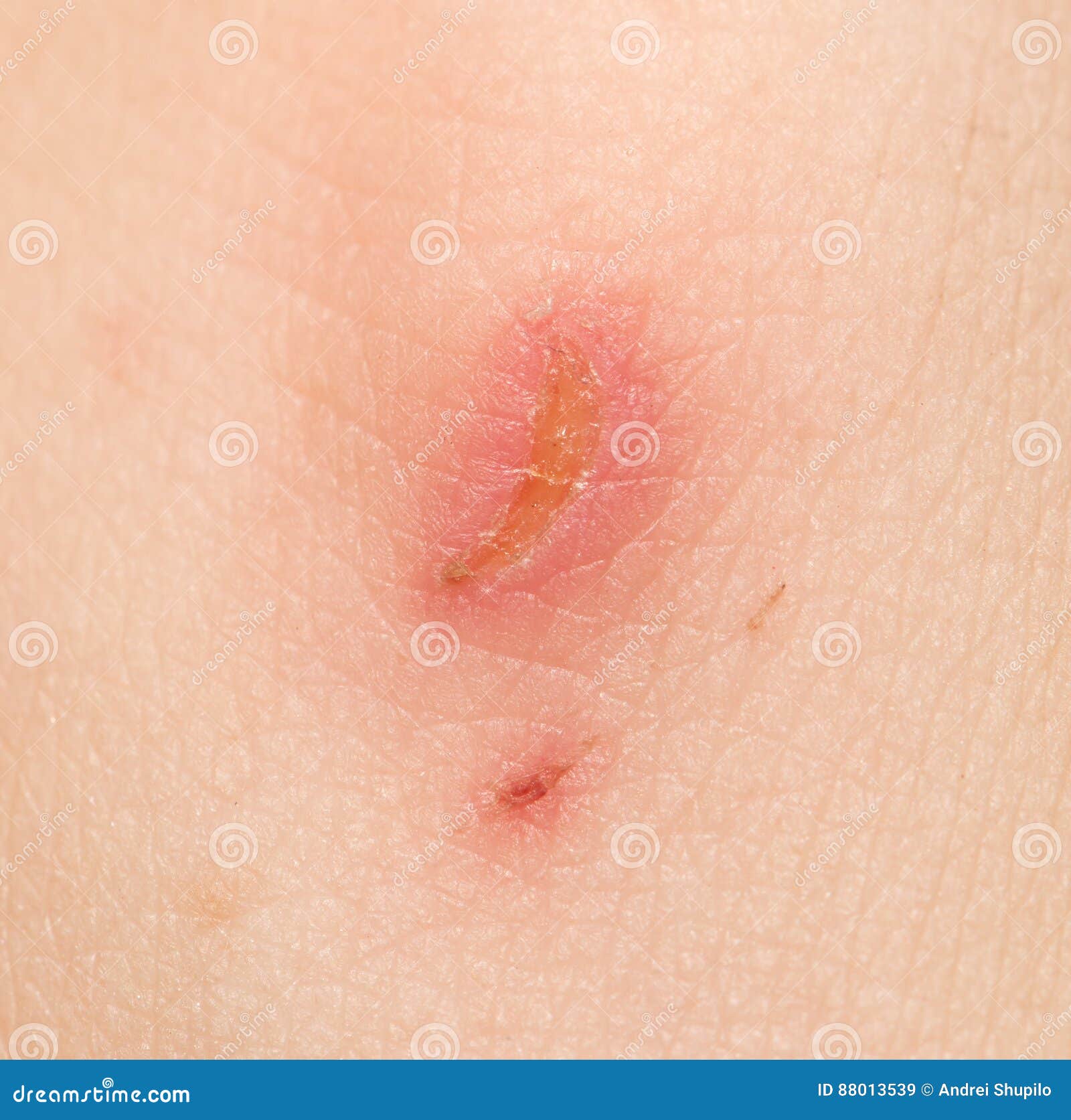 A wound on the skin stock image. Image of injured, accident - 88013539