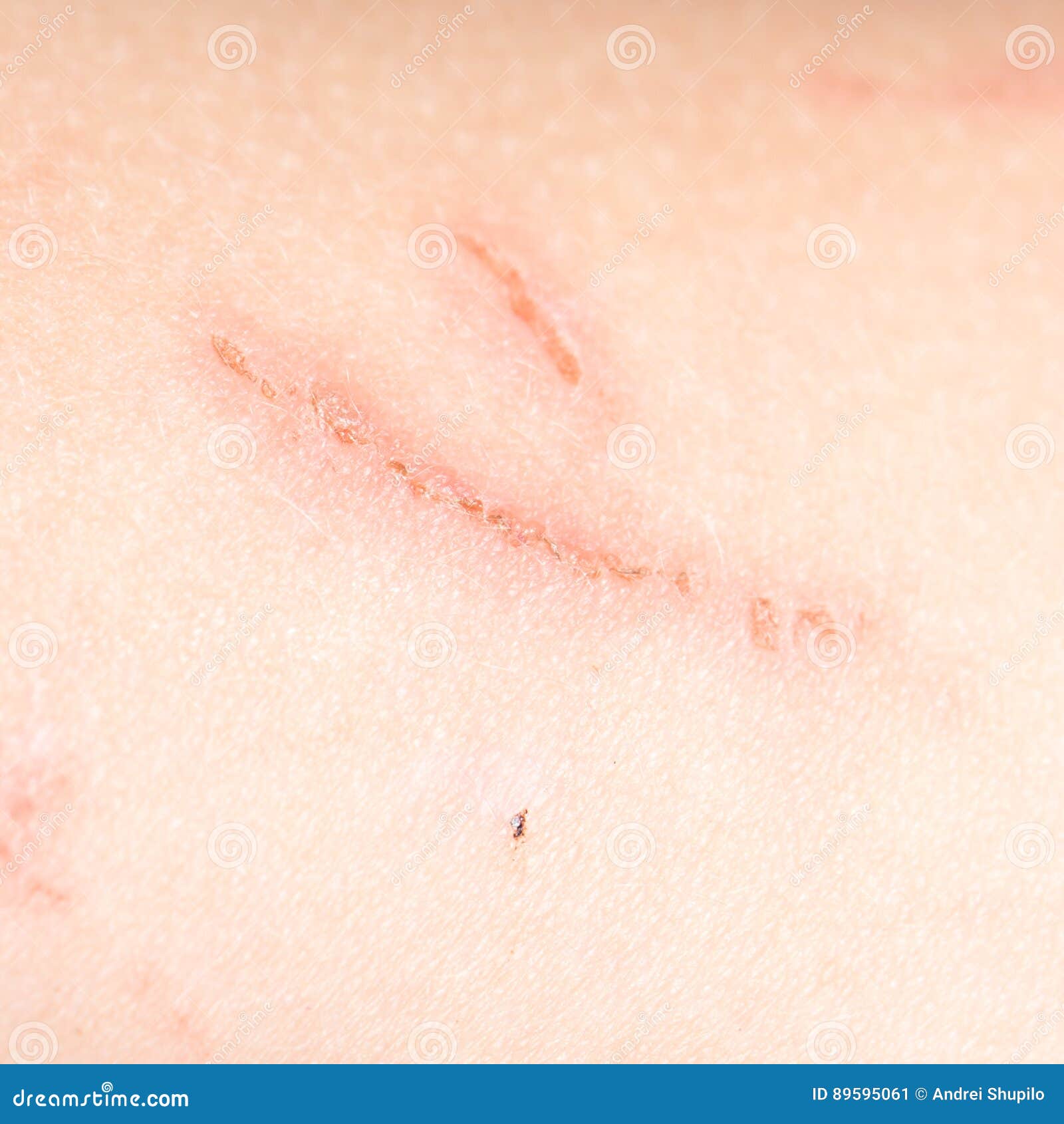 A wound on the skin. stock image. Image of hygiene, harm - 89595061