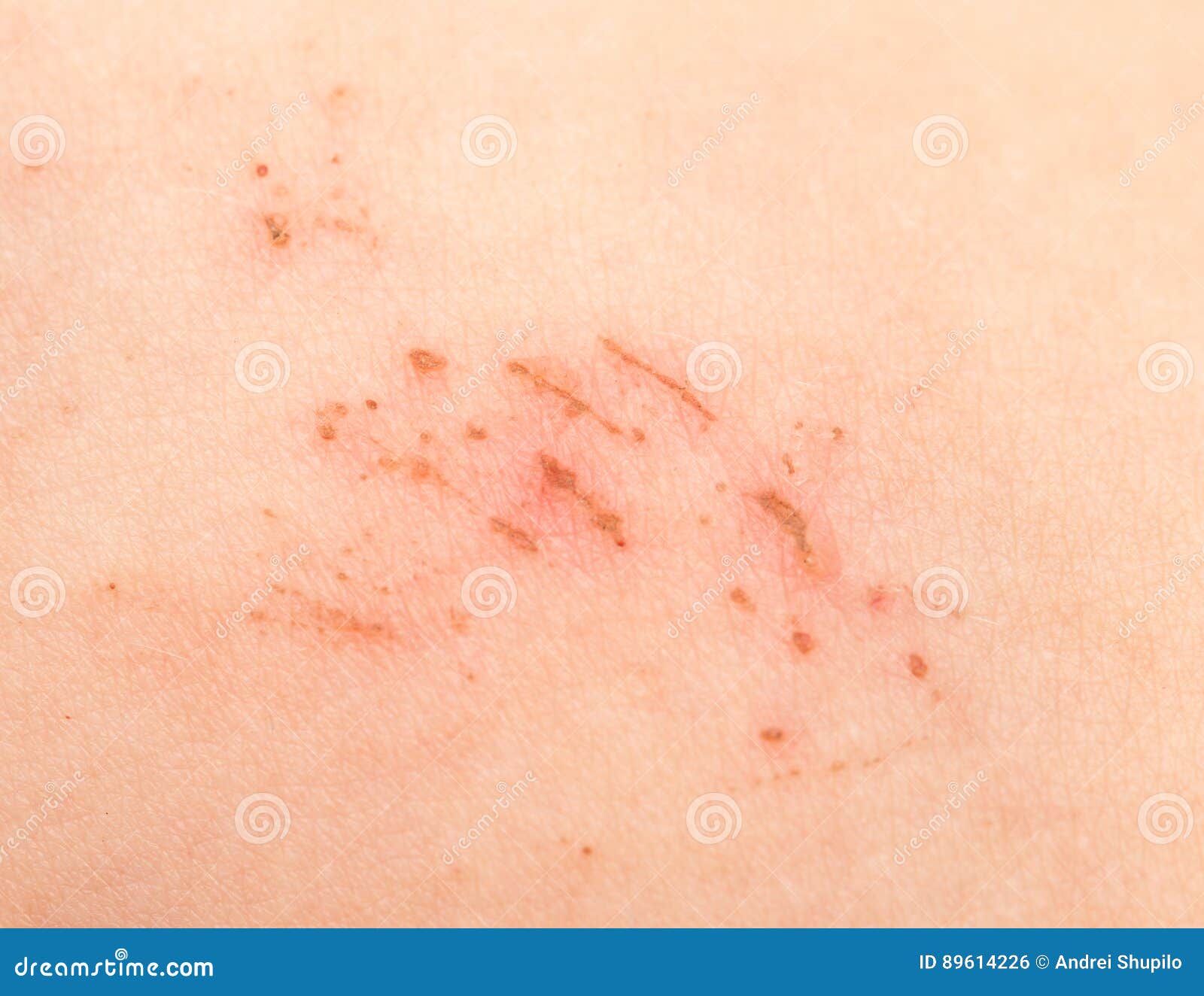 A wound on the skin. stock photo. Image of healthcare - 89614226