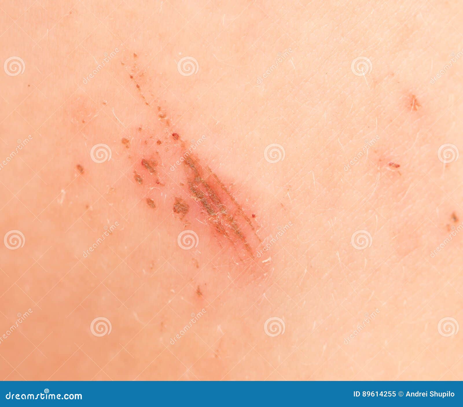A wound on the skin. stock image. Image of pain, healthcare - 89614255