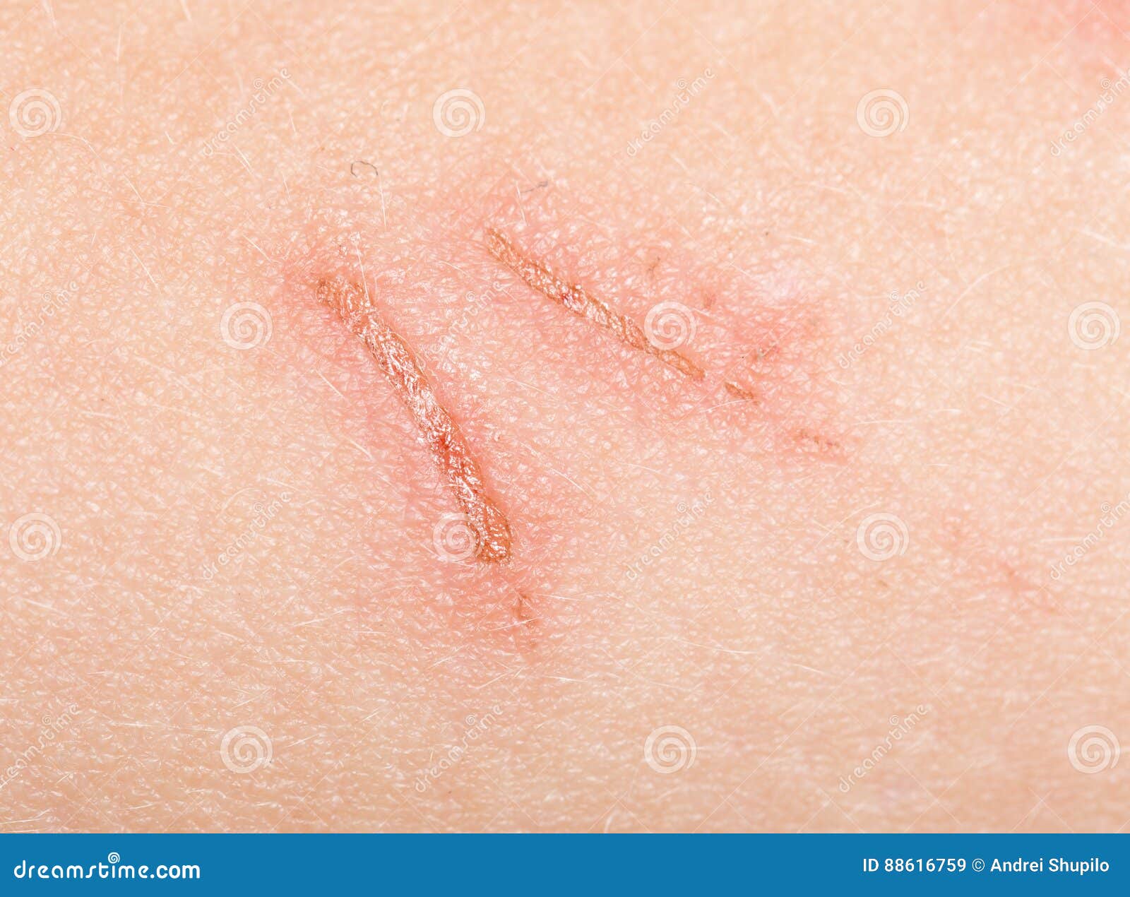A wound on the skin. close stock image. Image of healthcare - 88616759