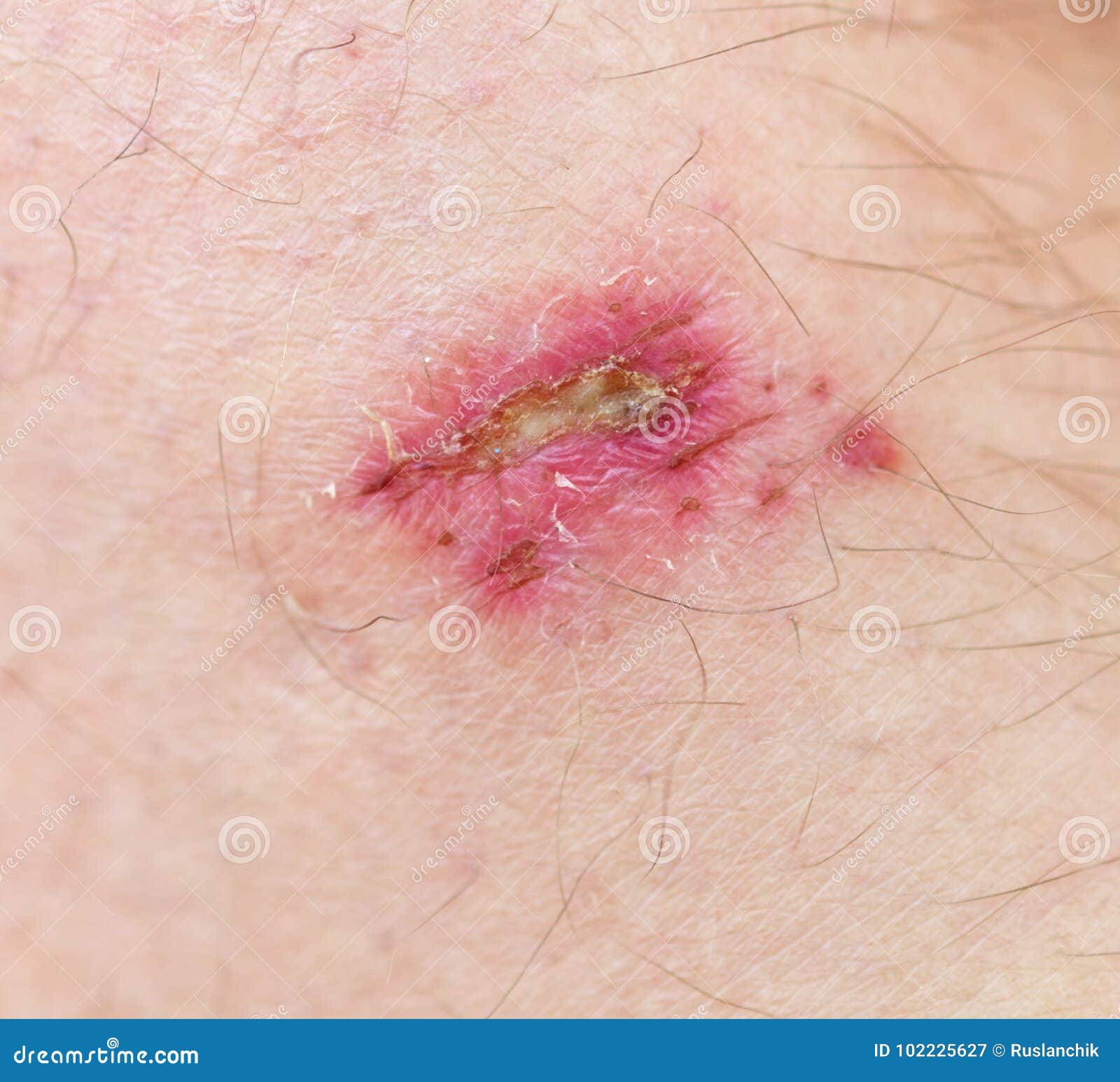 Wound on skin stock image. Image of hygiene, health - 102225627