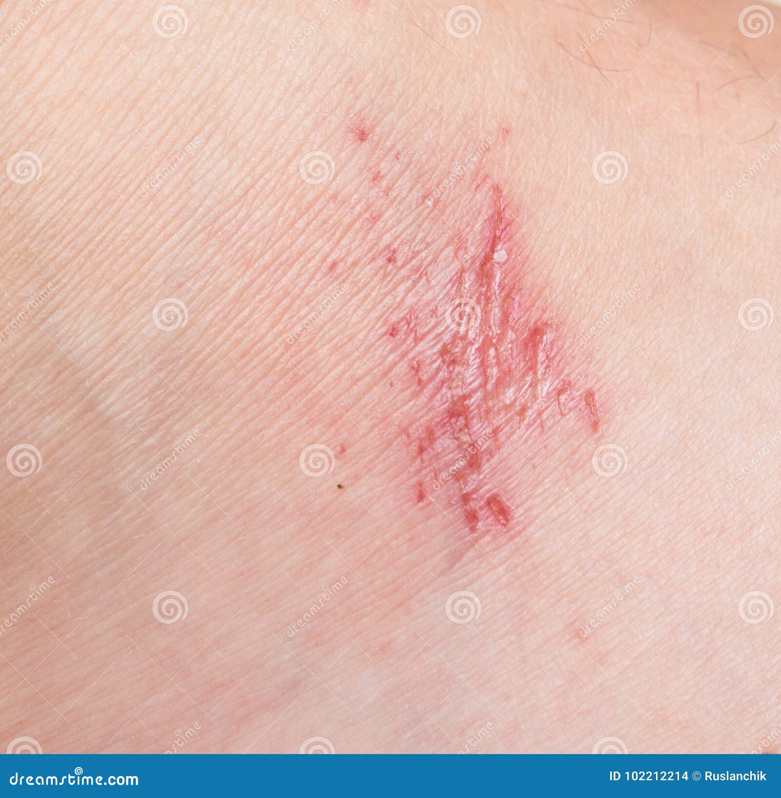 Wound on skin stock photo. Image of knee, scar, injury - 102212214