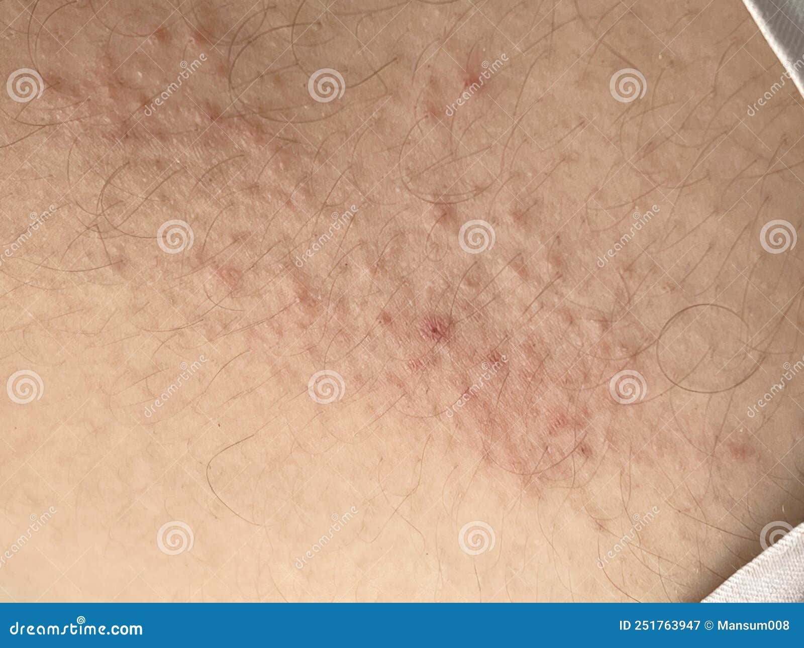 Wound on skin leg stock image. Image of allergic, injury - 251763947